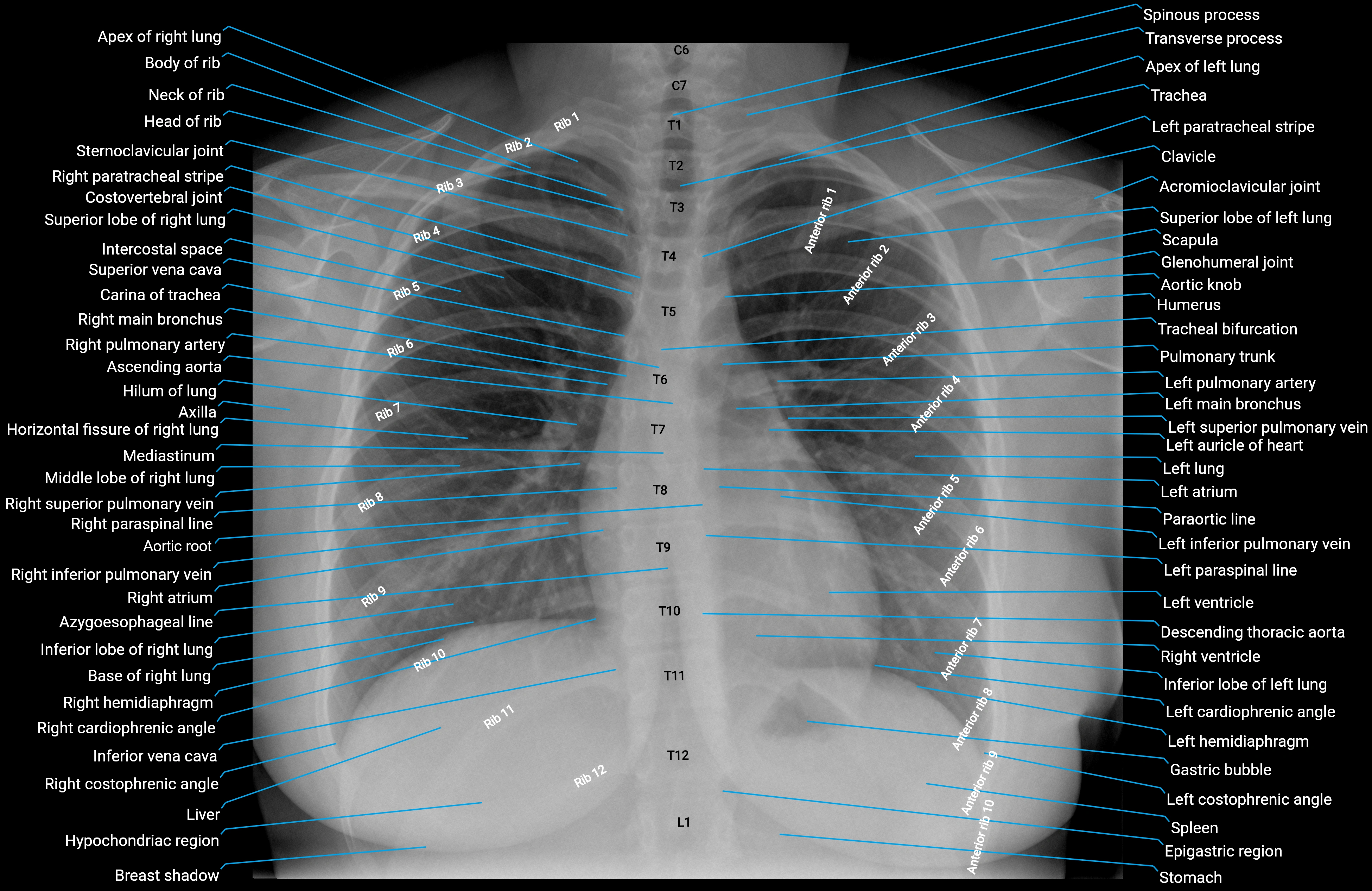 Chest X-ray Anatomy – AP & Lateral Views, Labeled CXR, Normal Chest Anatomy