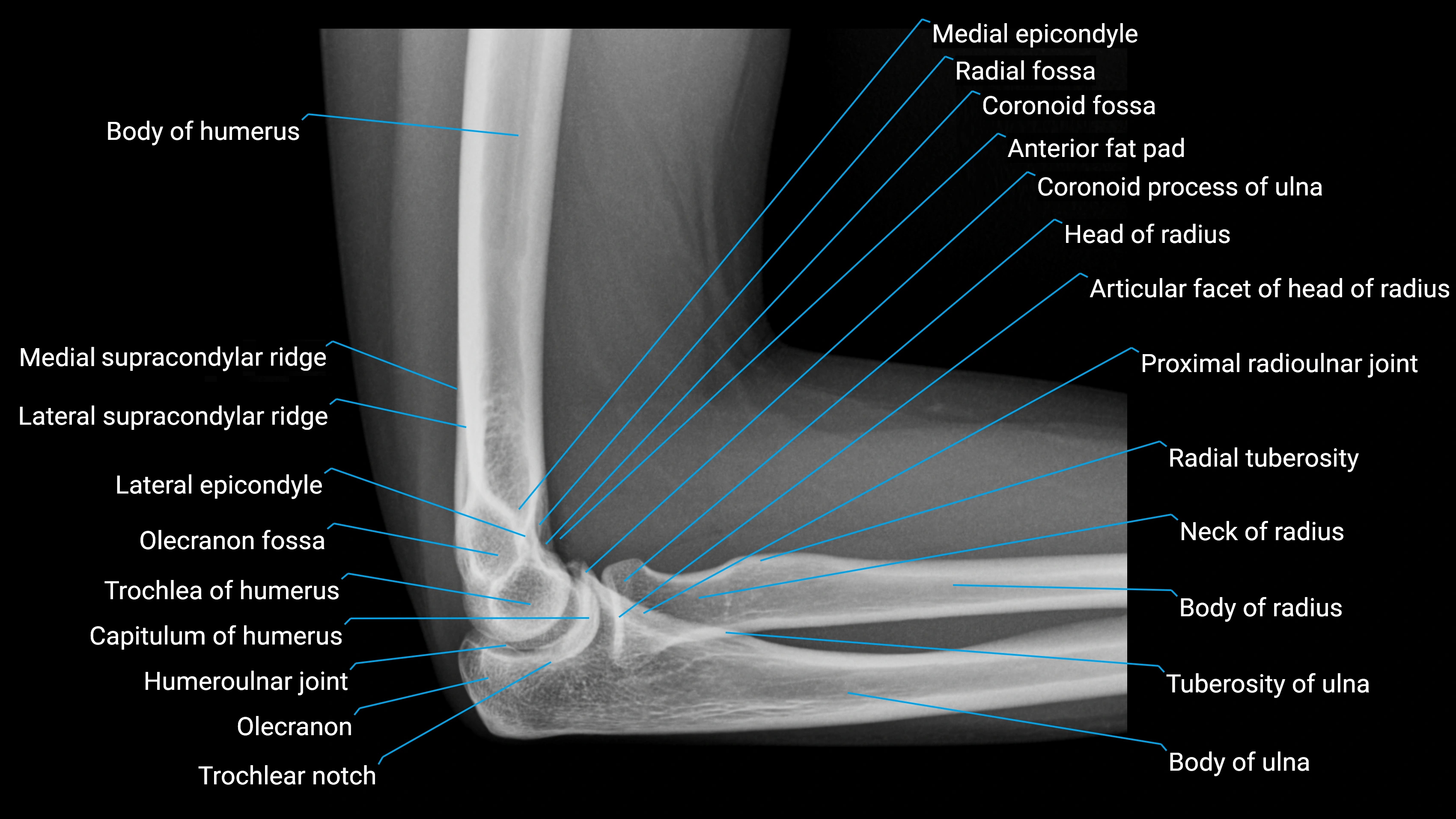 Elbow X-ray Anatomy – AP & Lateral Views with Labeled Structures