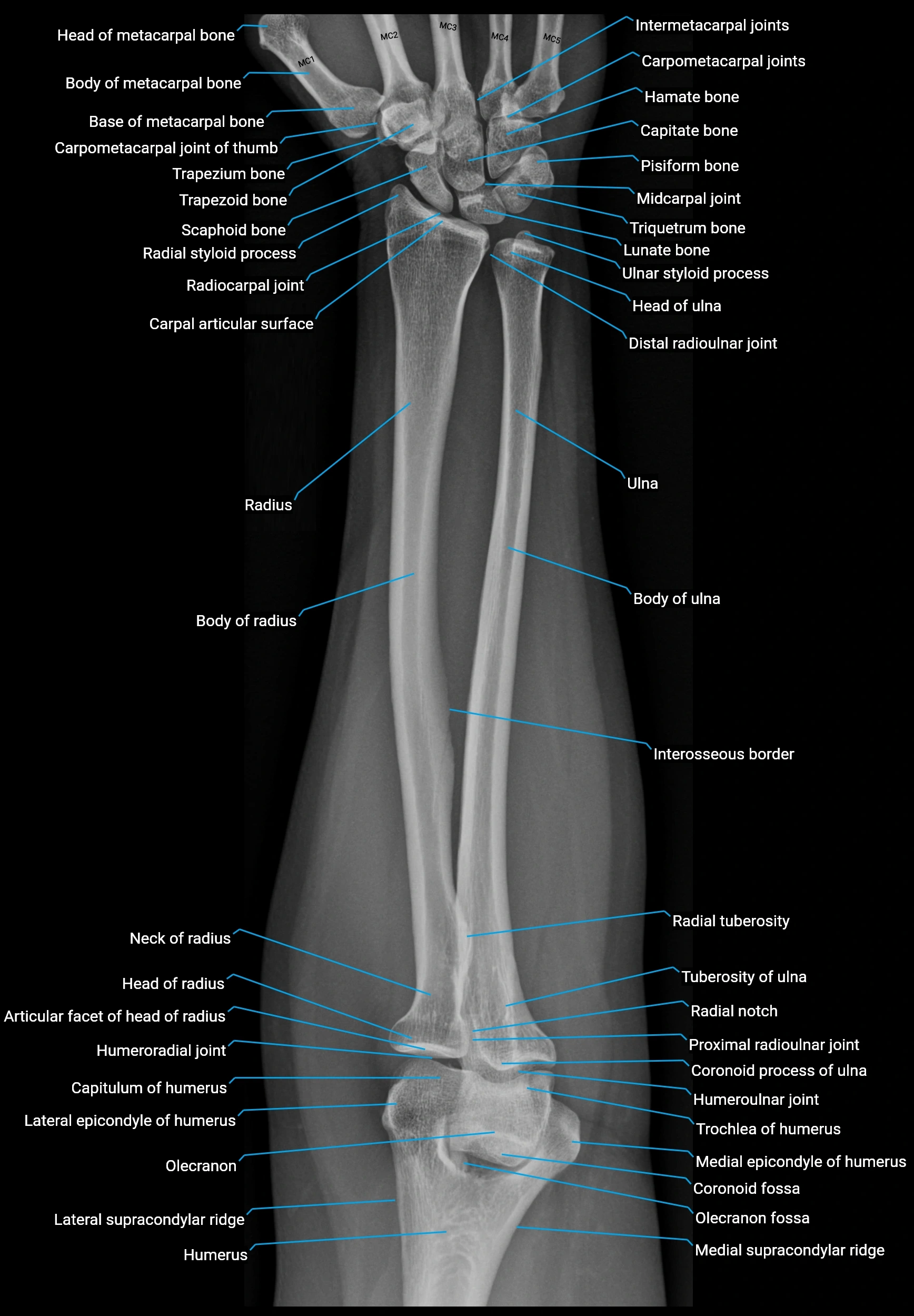 Forearm X-ray Anatomy – AP & Lateral View | Normal Labeled Radiographic ...