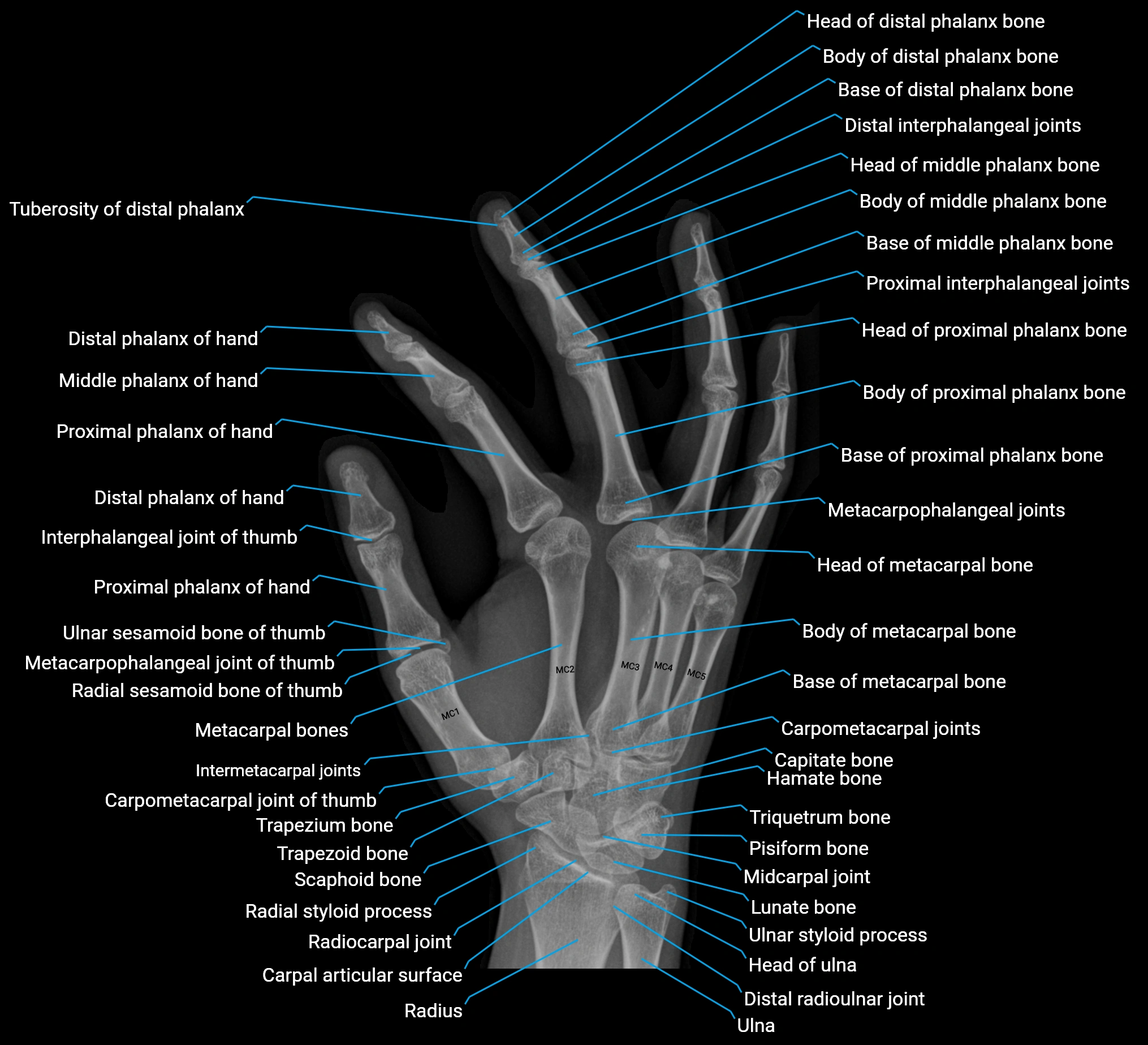 Hand X-Ray Anatomy – PA & Lateral Views With Labeled Images