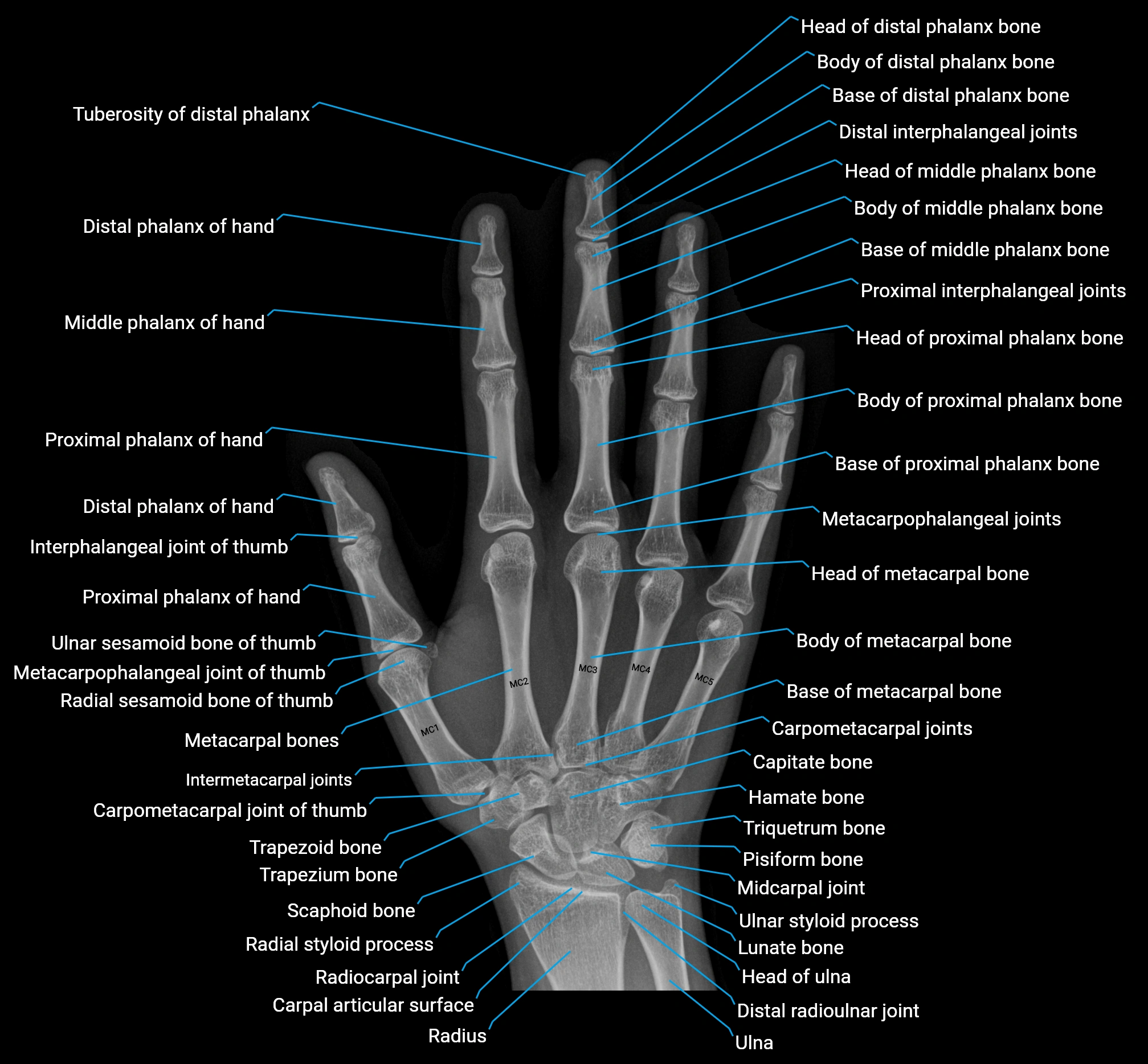Hand X-Ray Anatomy – PA & Lateral Views With Labeled Images