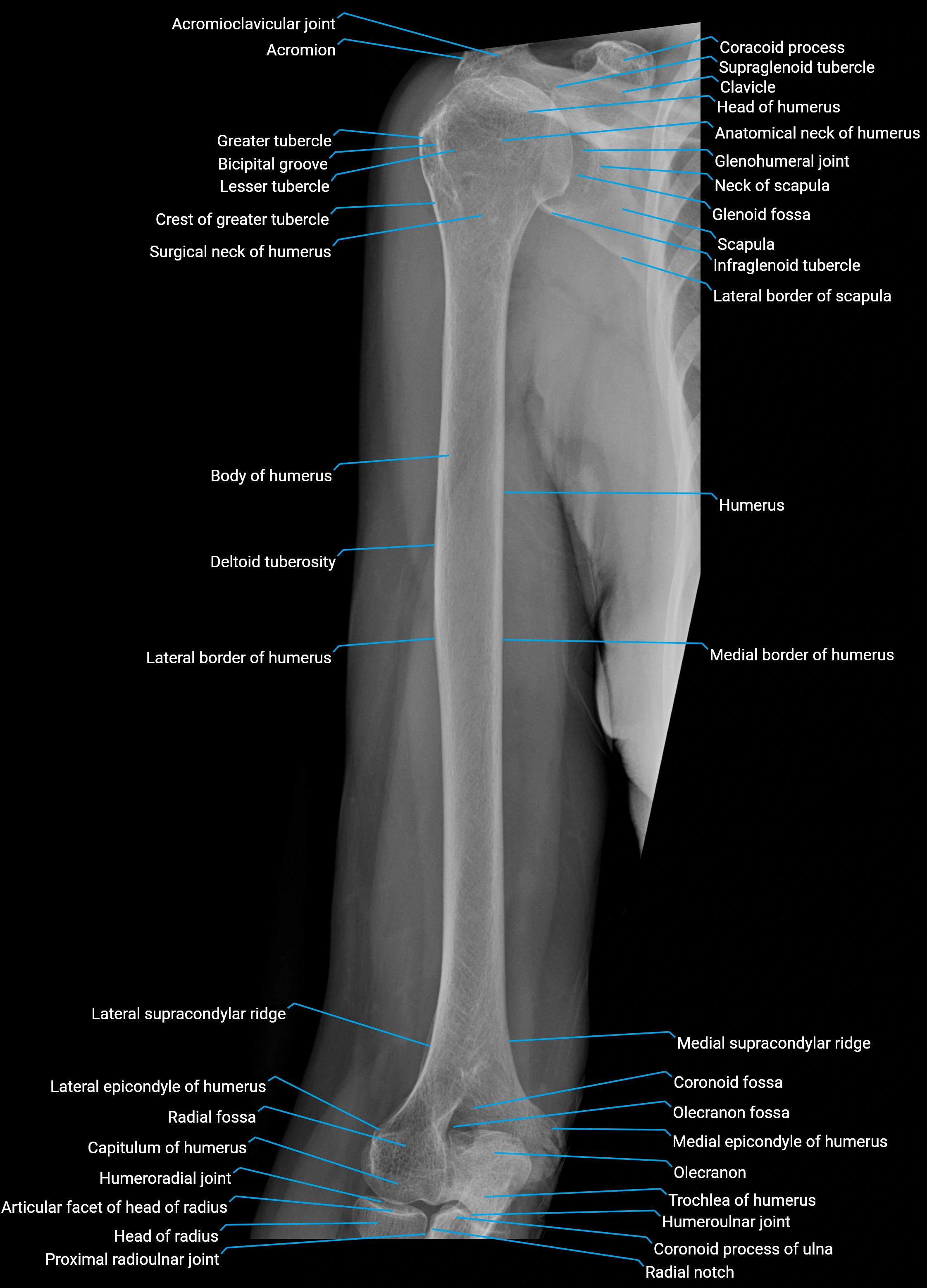 Normal Humerus X-Ray Anatomy – AP & Lateral Views with Labels