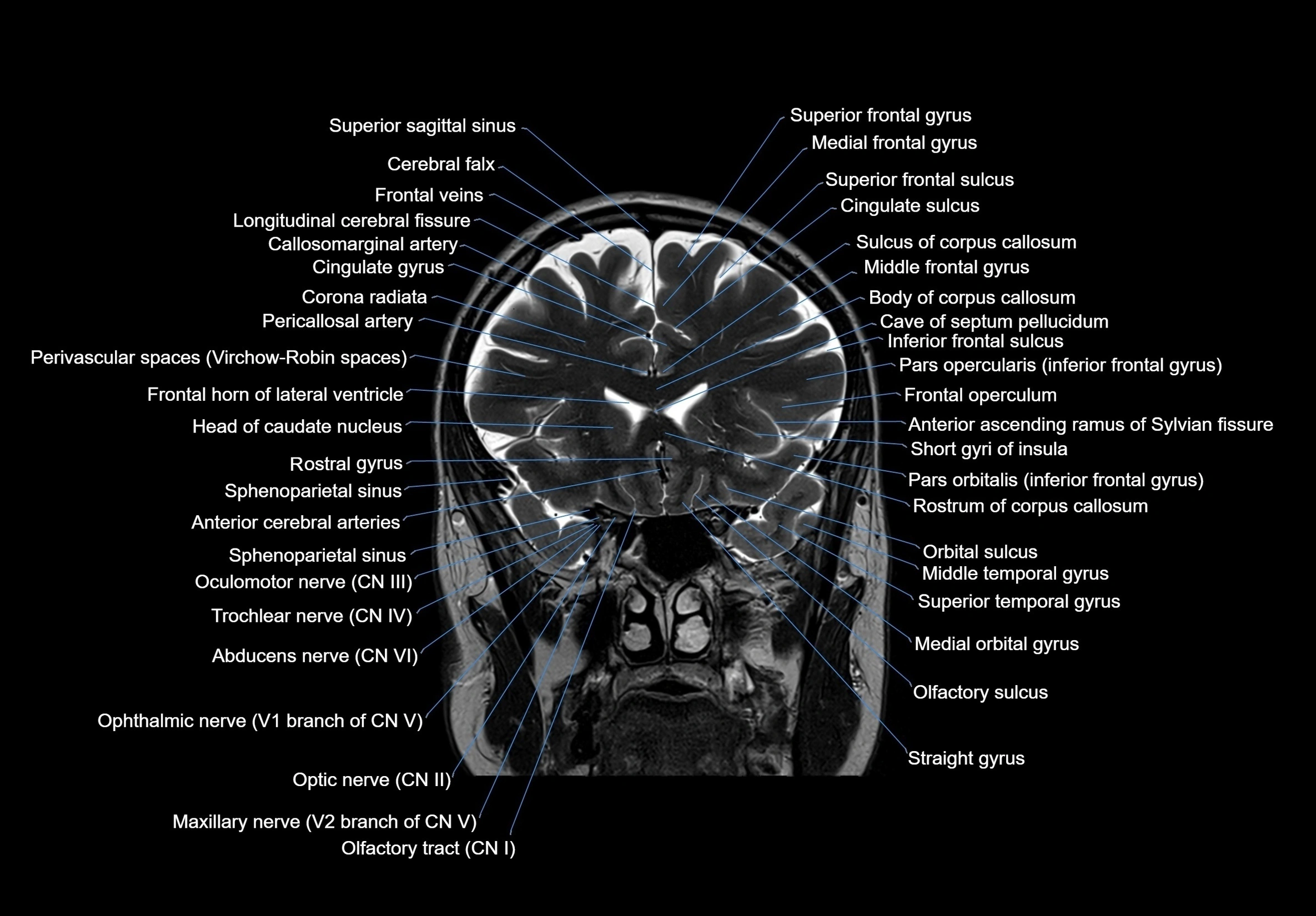MRI Brain Anatomy – Labeled Axial, Coronal & Sagittal Images
