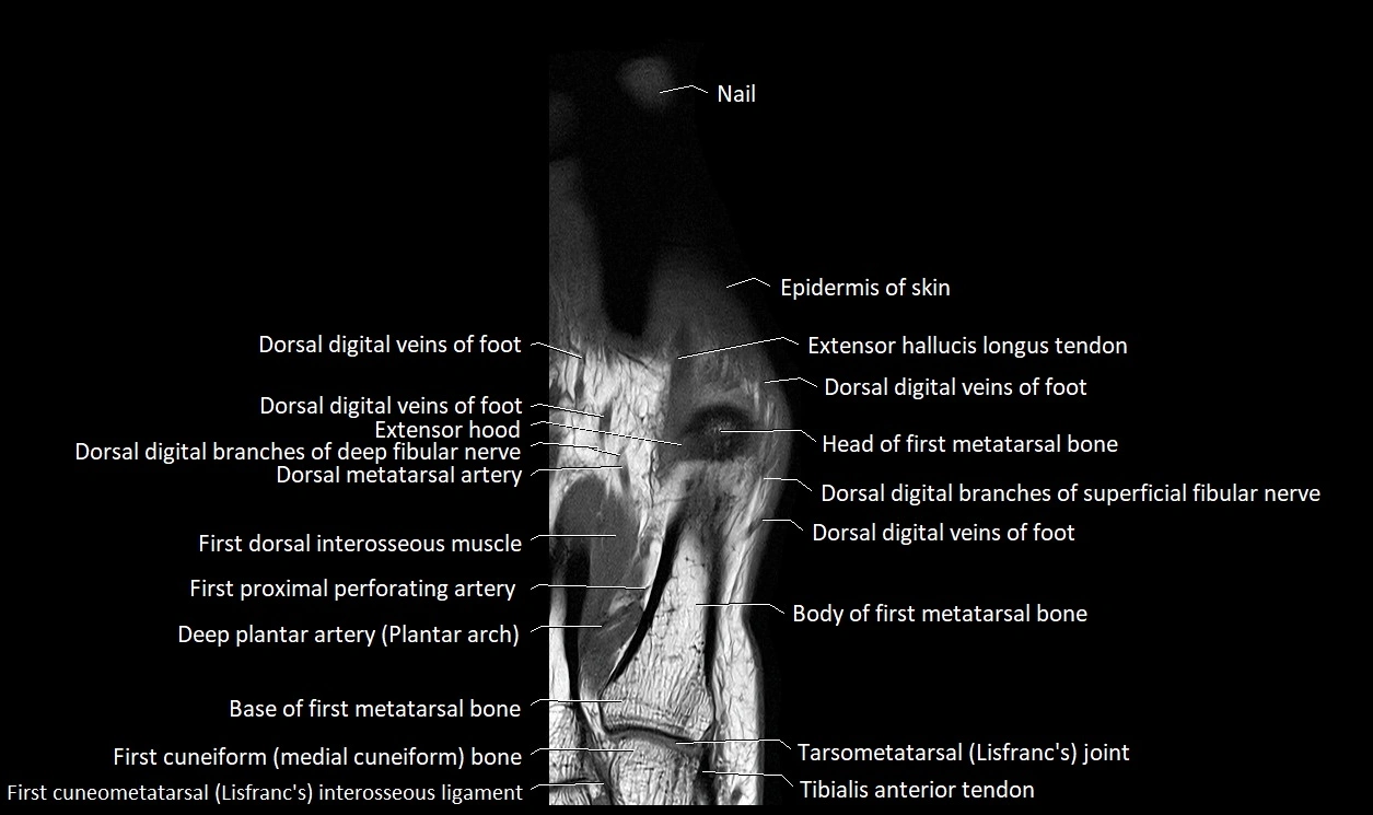 MRI Great Toe Anatomy – Labeled Axial, Coronal & Sagittal Cross-Sections