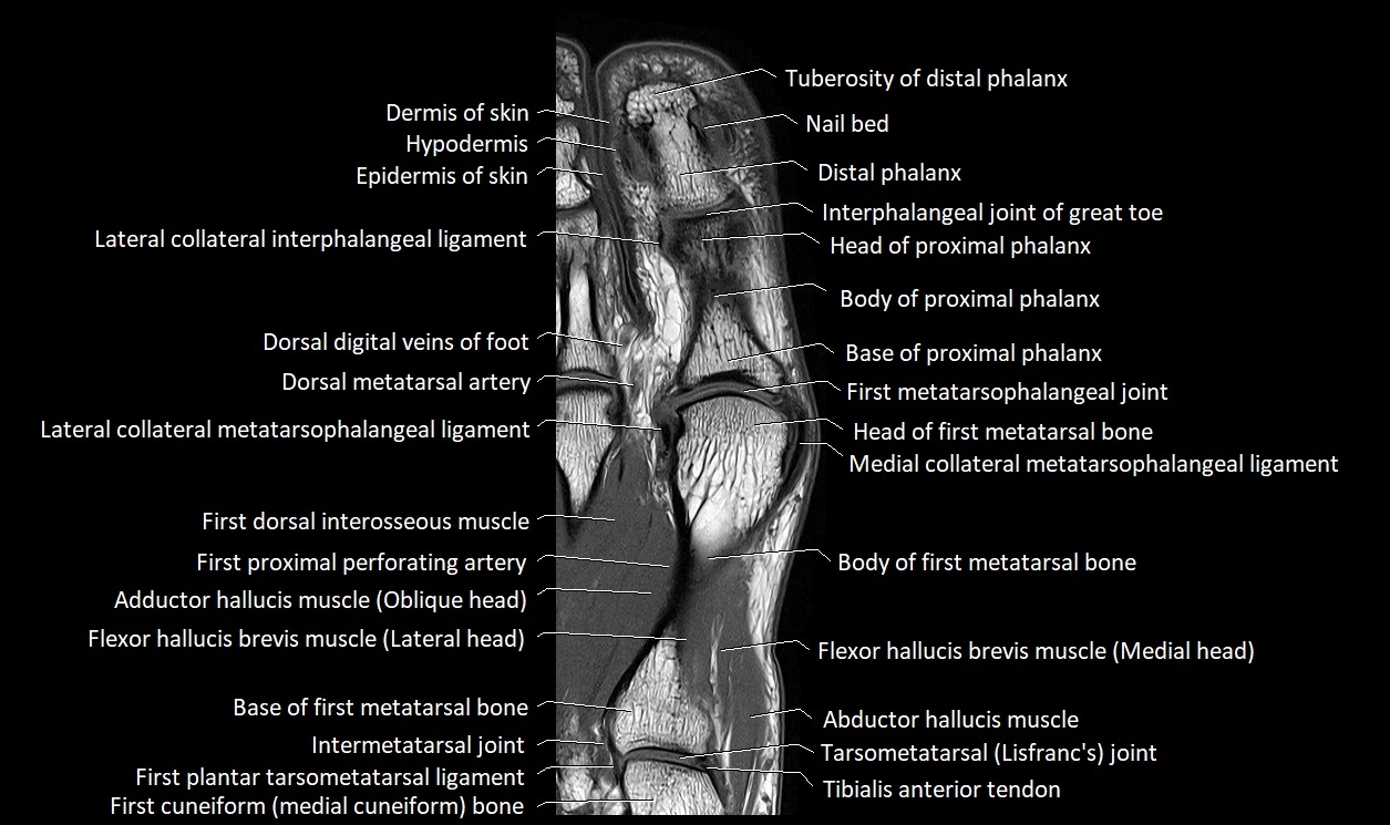 MRI Great Toe Anatomy – Labeled Axial, Coronal & Sagittal Cross-Sections