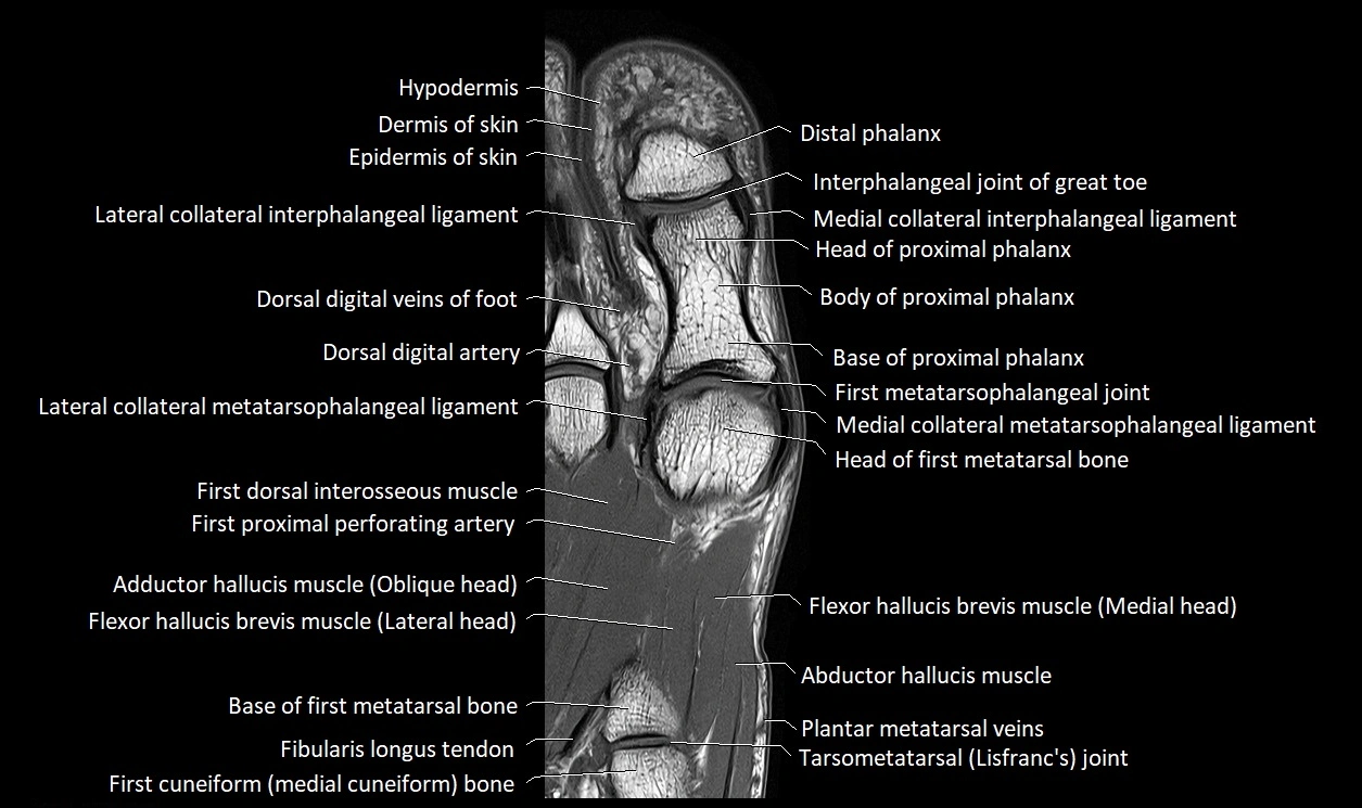 MRI Great Toe Anatomy – Labeled Axial, Coronal & Sagittal Cross-Sections