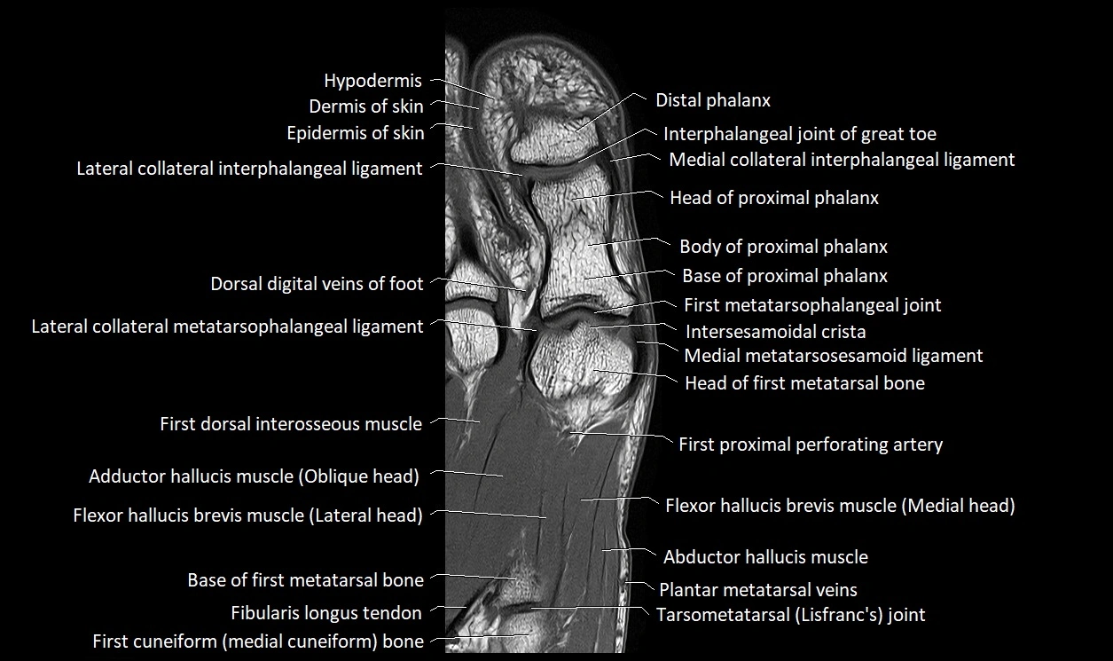 MRI Great Toe Anatomy – Labeled Axial, Coronal & Sagittal Cross-Sections
