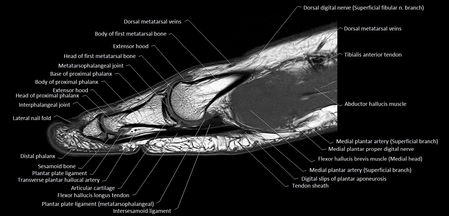 MRI Great Toe Anatomy – Labeled Axial, Coronal & Sagittal Cross-Sections