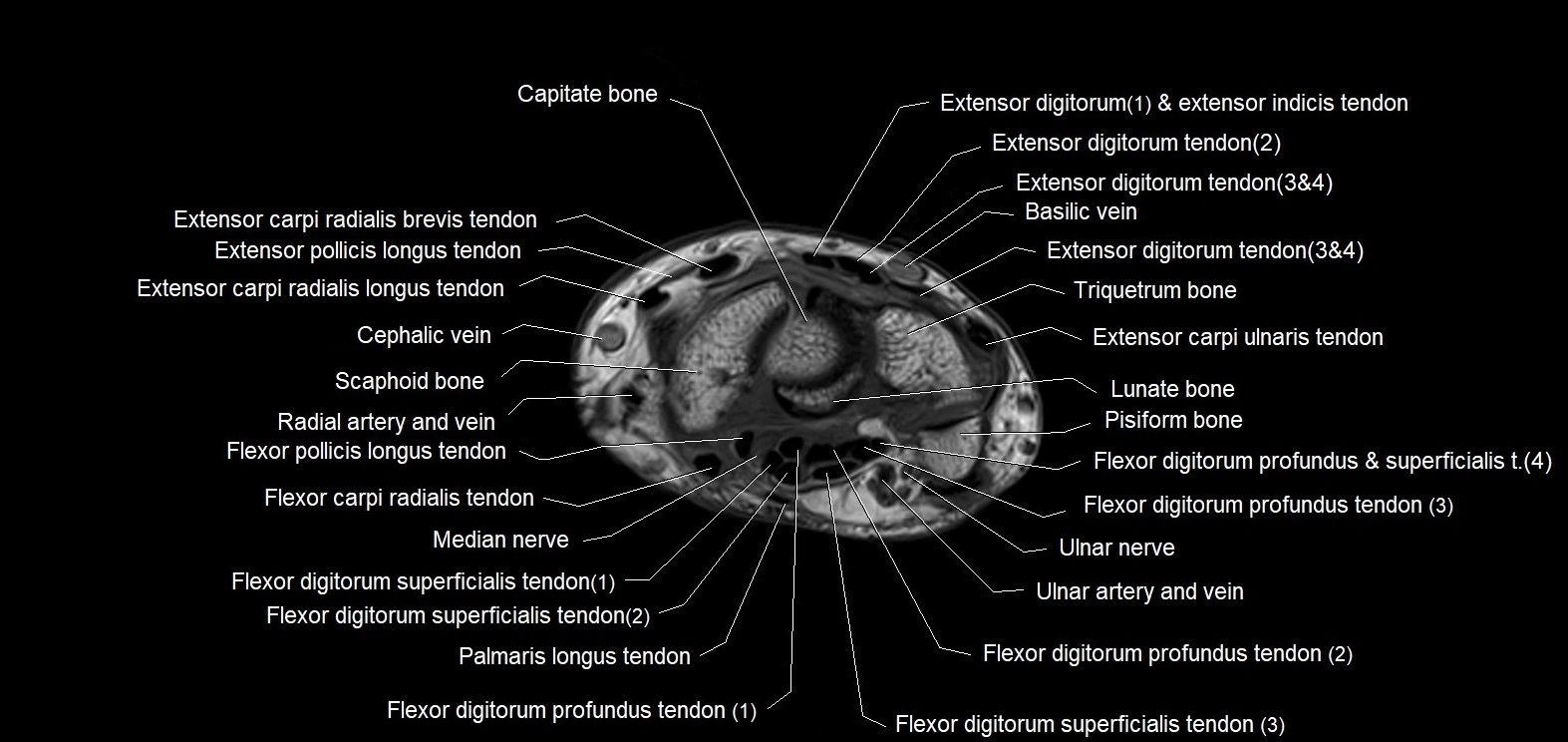 MRI Hand Anatomy – Labeled Axial, Coronal & Sagittal Images