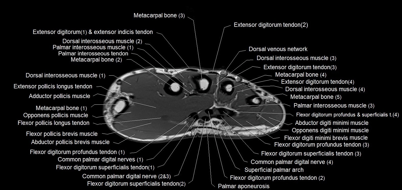MRI Hand Anatomy – Labeled Axial, Coronal & Sagittal Images