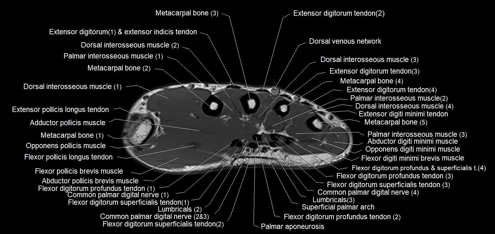 MRI Hand Anatomy – Labeled Axial, Coronal & Sagittal Images