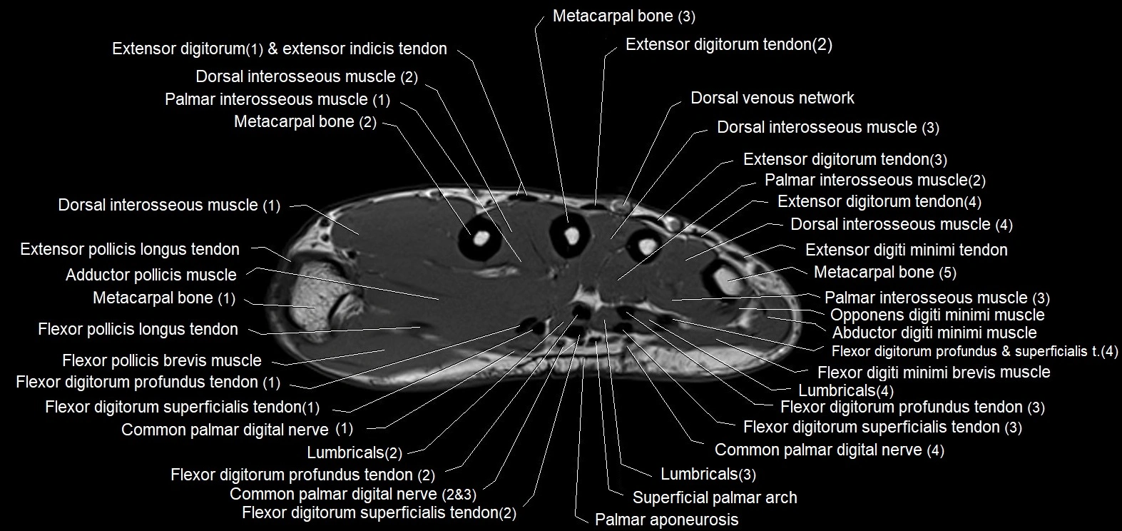 MRI Hand Anatomy – Labeled Axial, Coronal & Sagittal Images