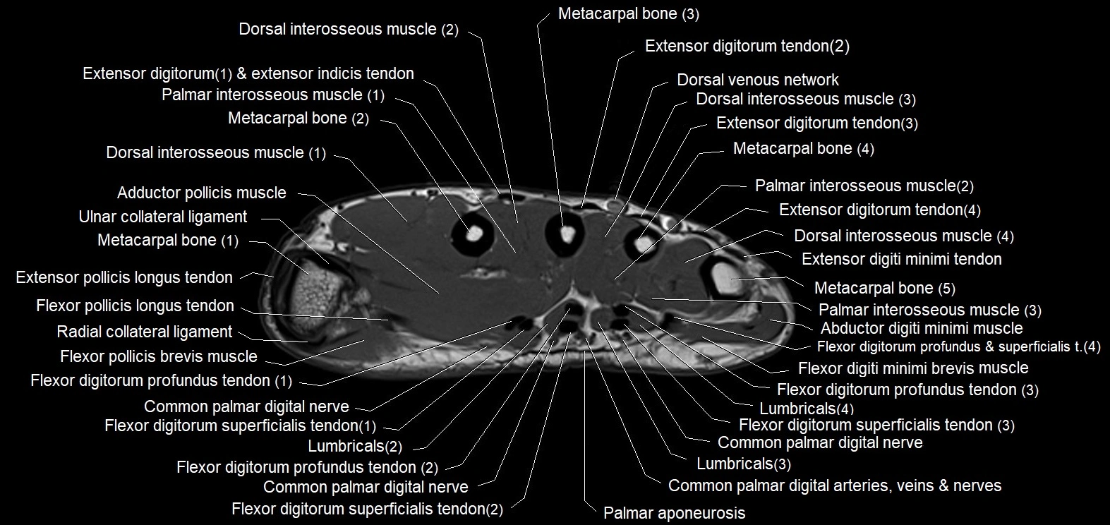 MRI Hand Anatomy – Labeled Axial, Coronal & Sagittal Images