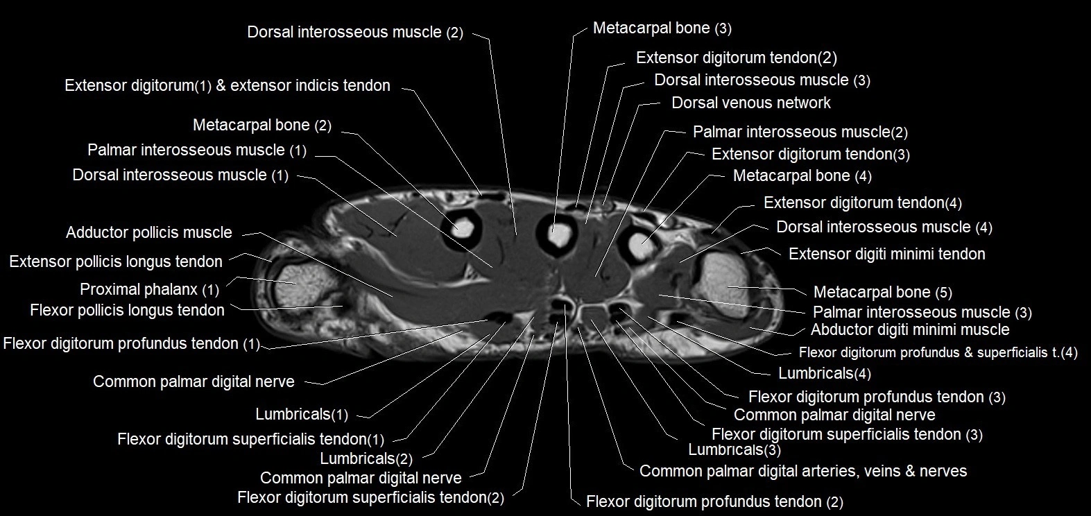 MRI Hand Anatomy – Labeled Axial, Coronal & Sagittal Images