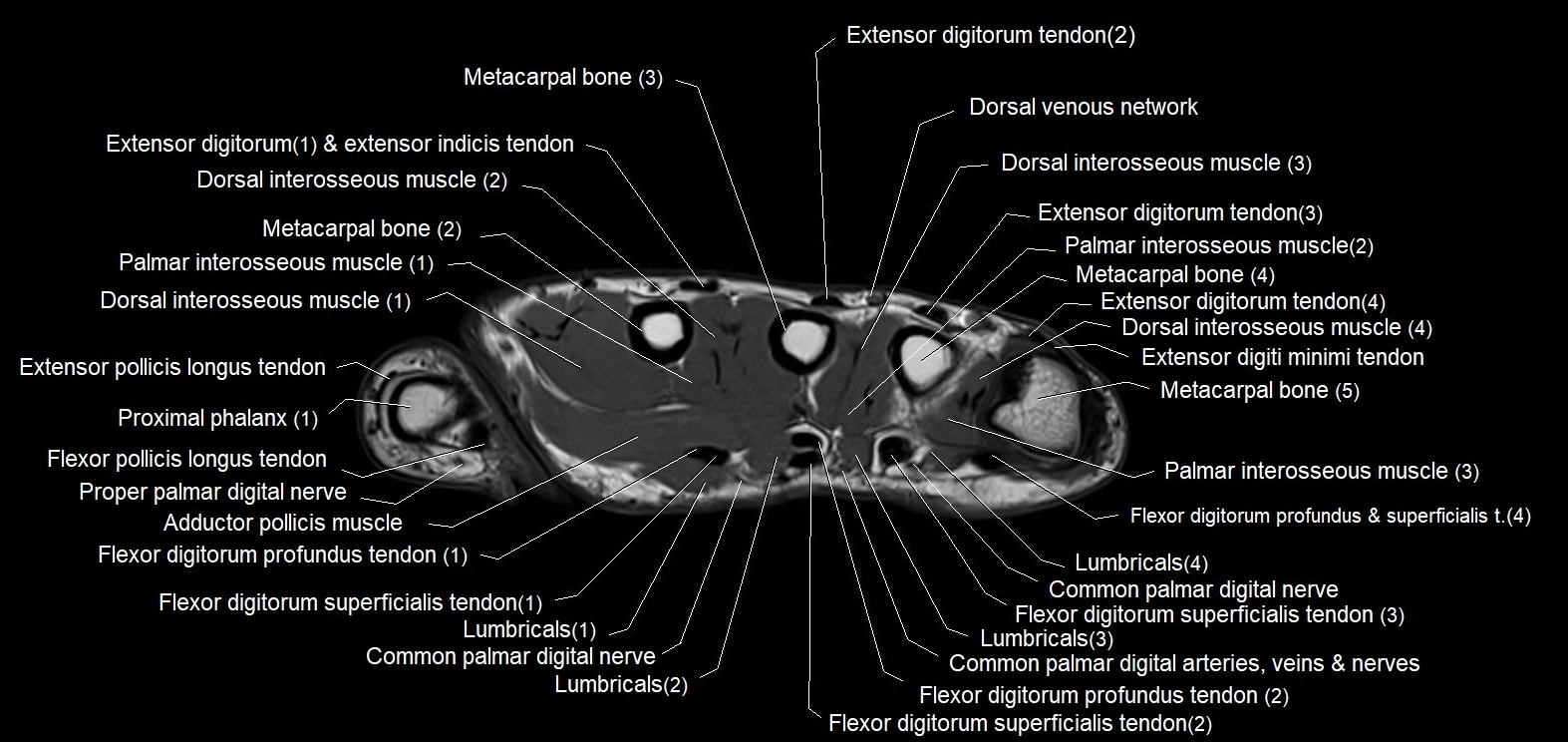 MRI Hand Anatomy – Labeled Axial, Coronal & Sagittal Images