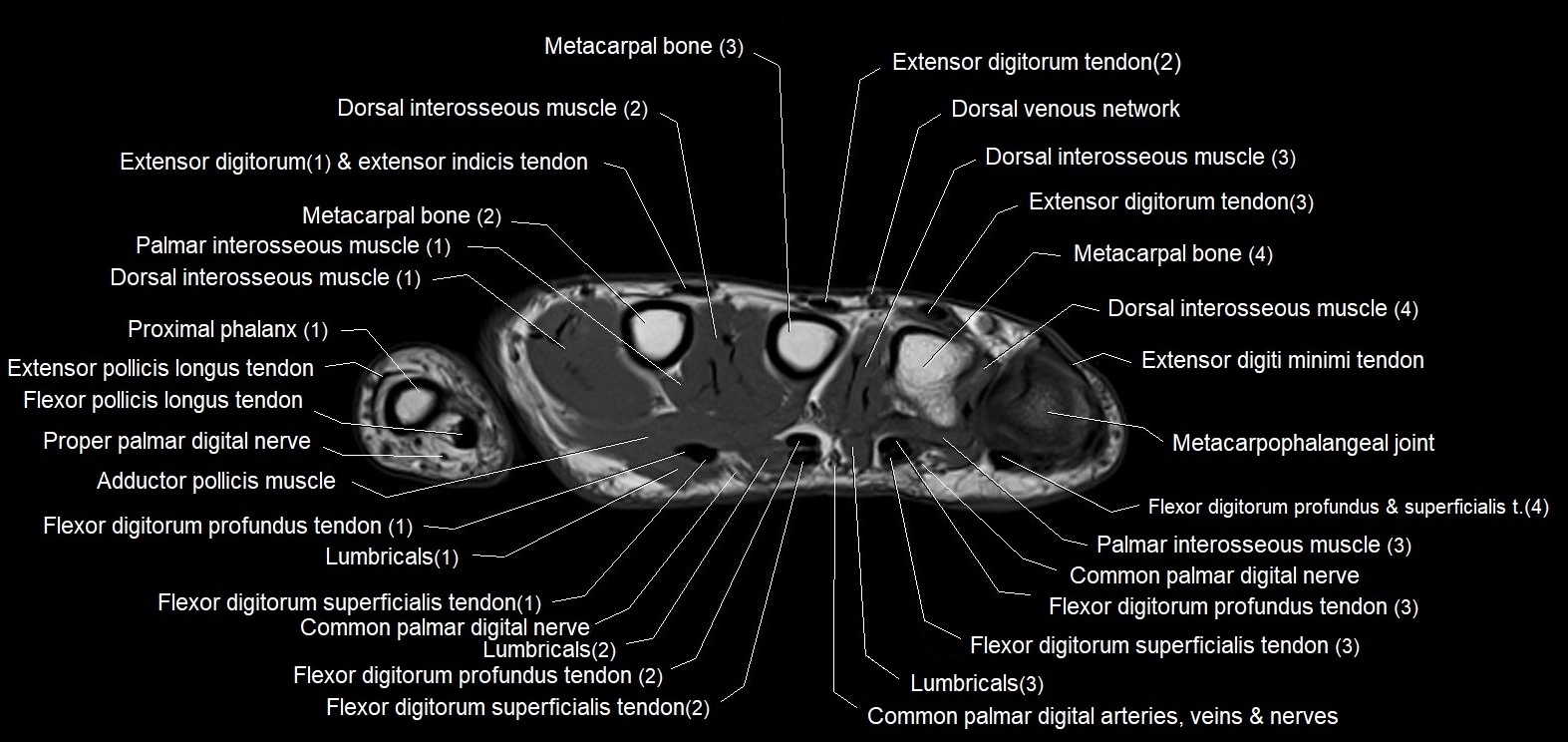 MRI Hand Anatomy – Labeled Axial, Coronal & Sagittal Images