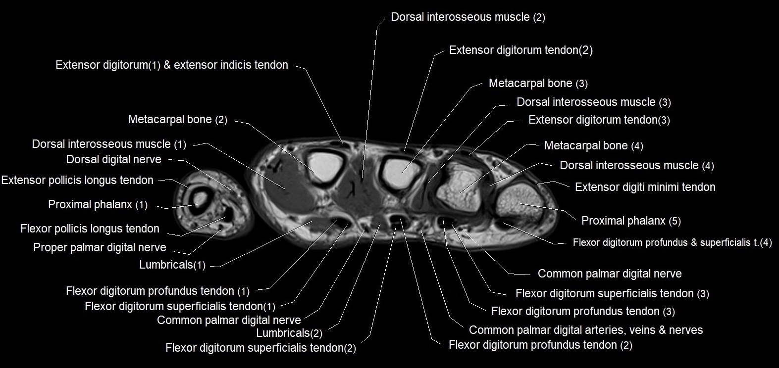 MRI Hand Anatomy – Labeled Axial, Coronal & Sagittal Images