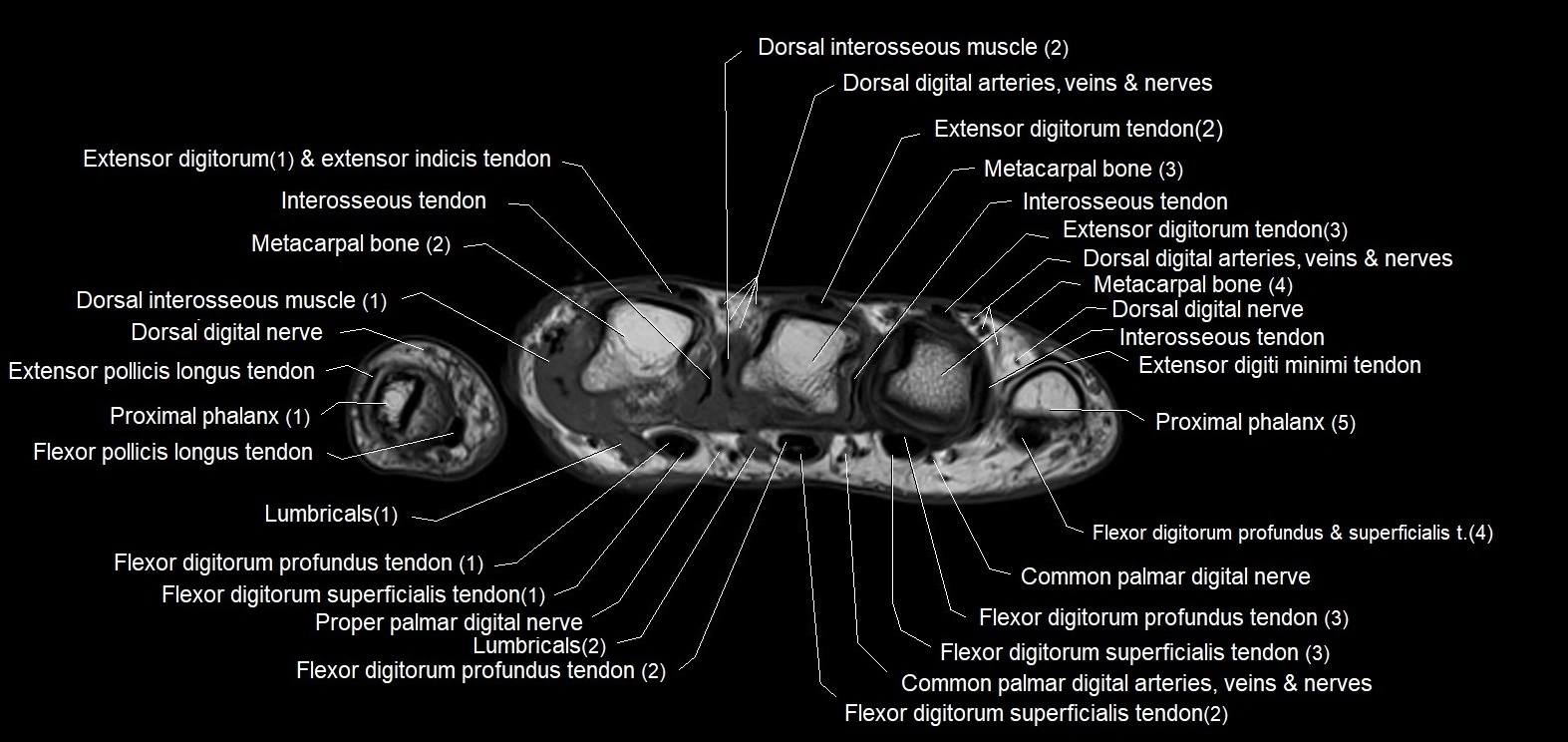 MRI Hand Anatomy – Labeled Axial, Coronal & Sagittal Images