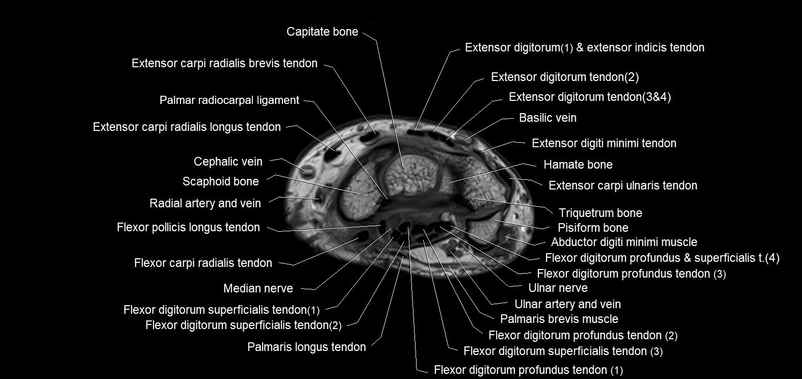 MRI Hand Anatomy – Labeled Axial, Coronal & Sagittal Images