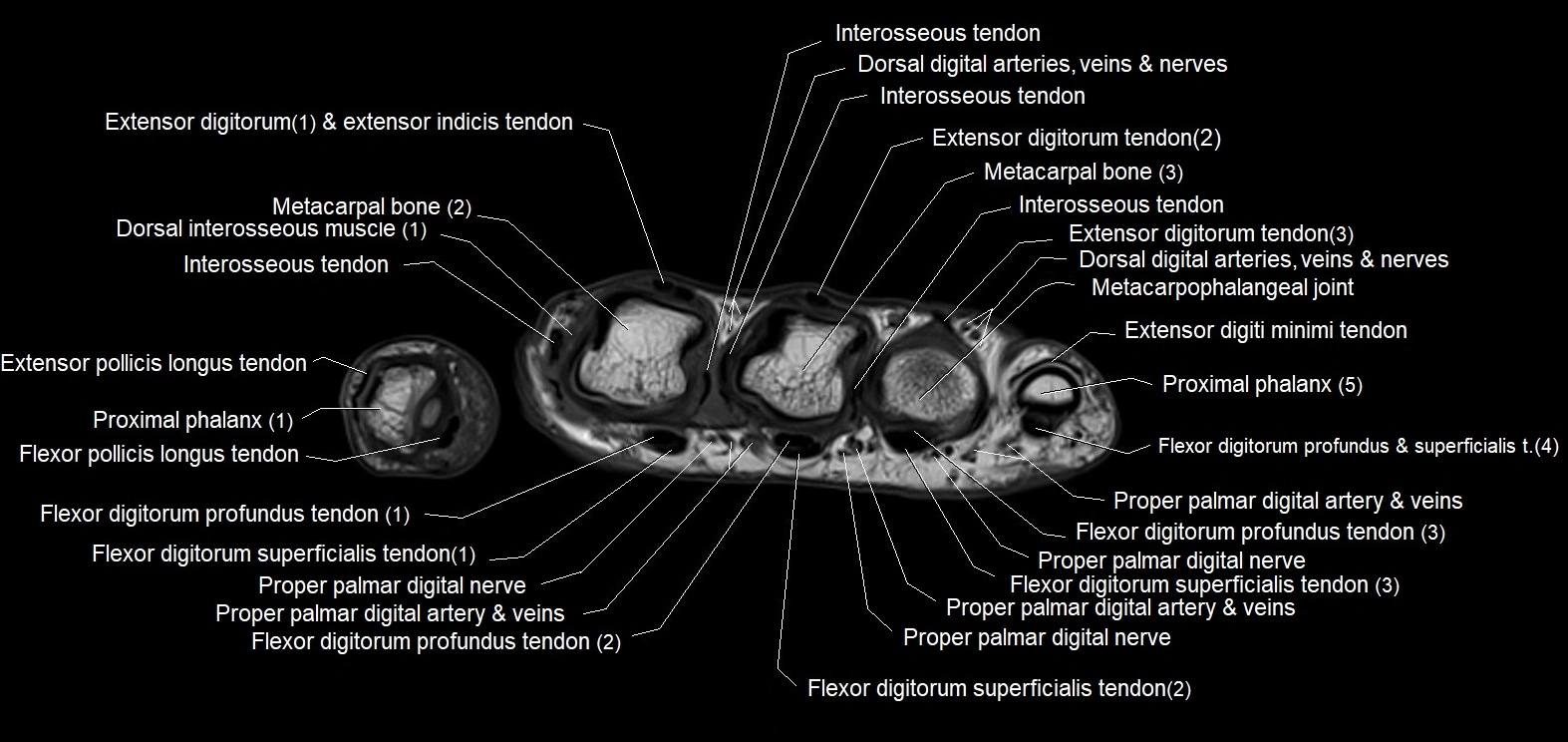 MRI Hand Anatomy – Labeled Axial, Coronal & Sagittal Images