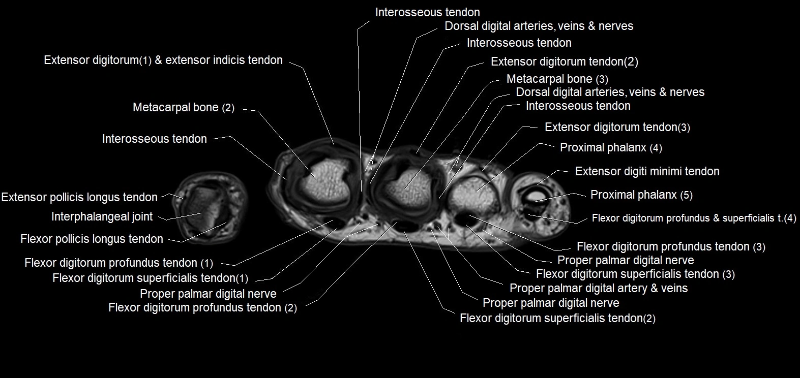 MRI Hand Anatomy – Labeled Axial, Coronal & Sagittal Images
