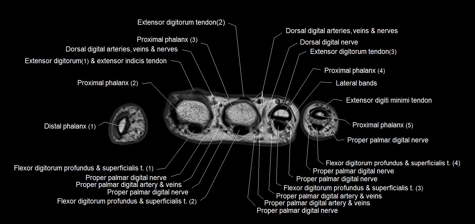 MRI Hand Anatomy – Labeled Axial, Coronal & Sagittal Images