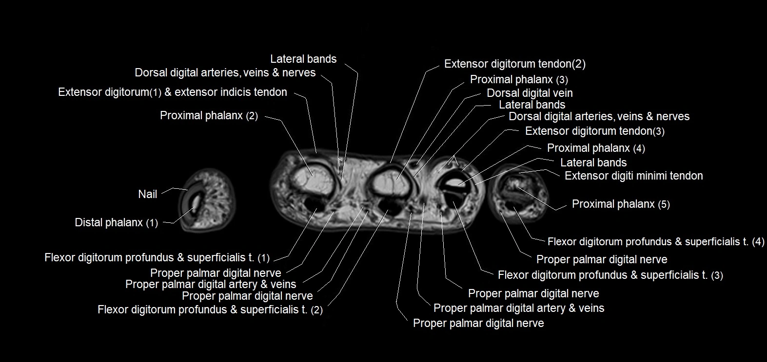 MRI Hand Anatomy – Labeled Axial, Coronal & Sagittal Images