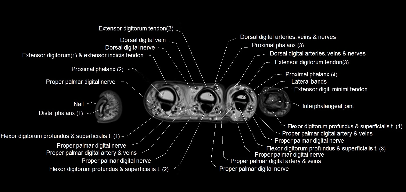 MRI Hand Anatomy – Labeled Axial, Coronal & Sagittal Images