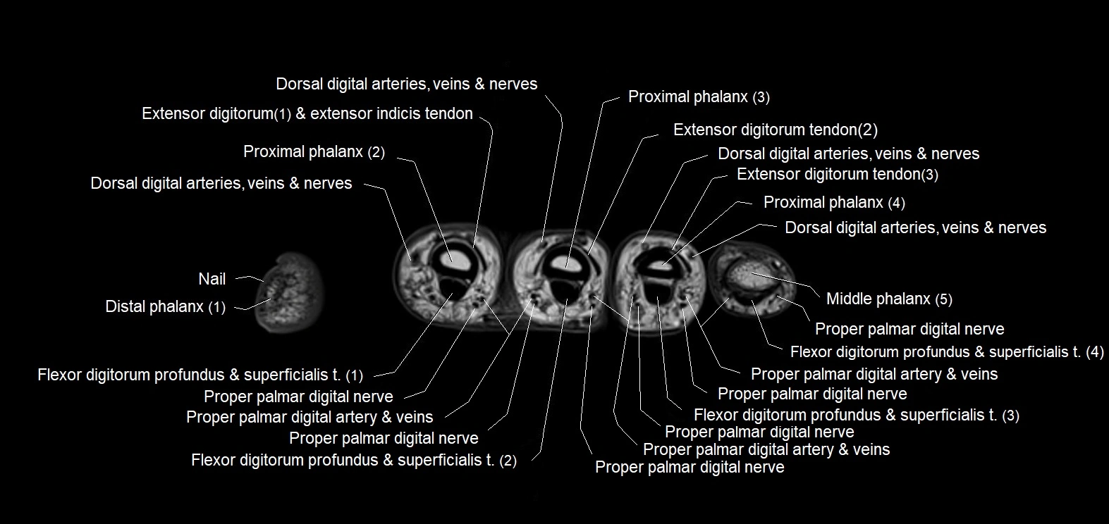 MRI Hand Anatomy – Labeled Axial, Coronal & Sagittal Images