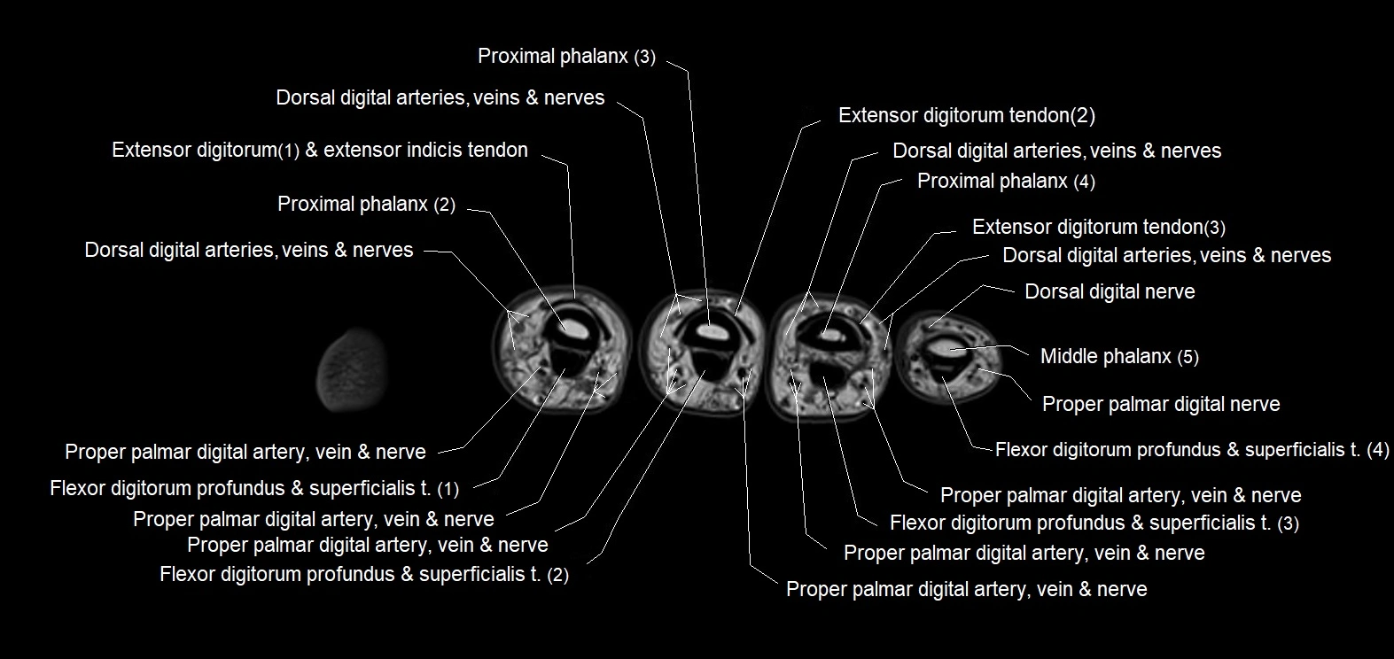 MRI Hand Anatomy – Labeled Axial, Coronal & Sagittal Images