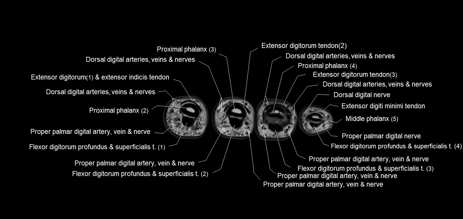 MRI Hand Anatomy – Labeled Axial, Coronal & Sagittal Images