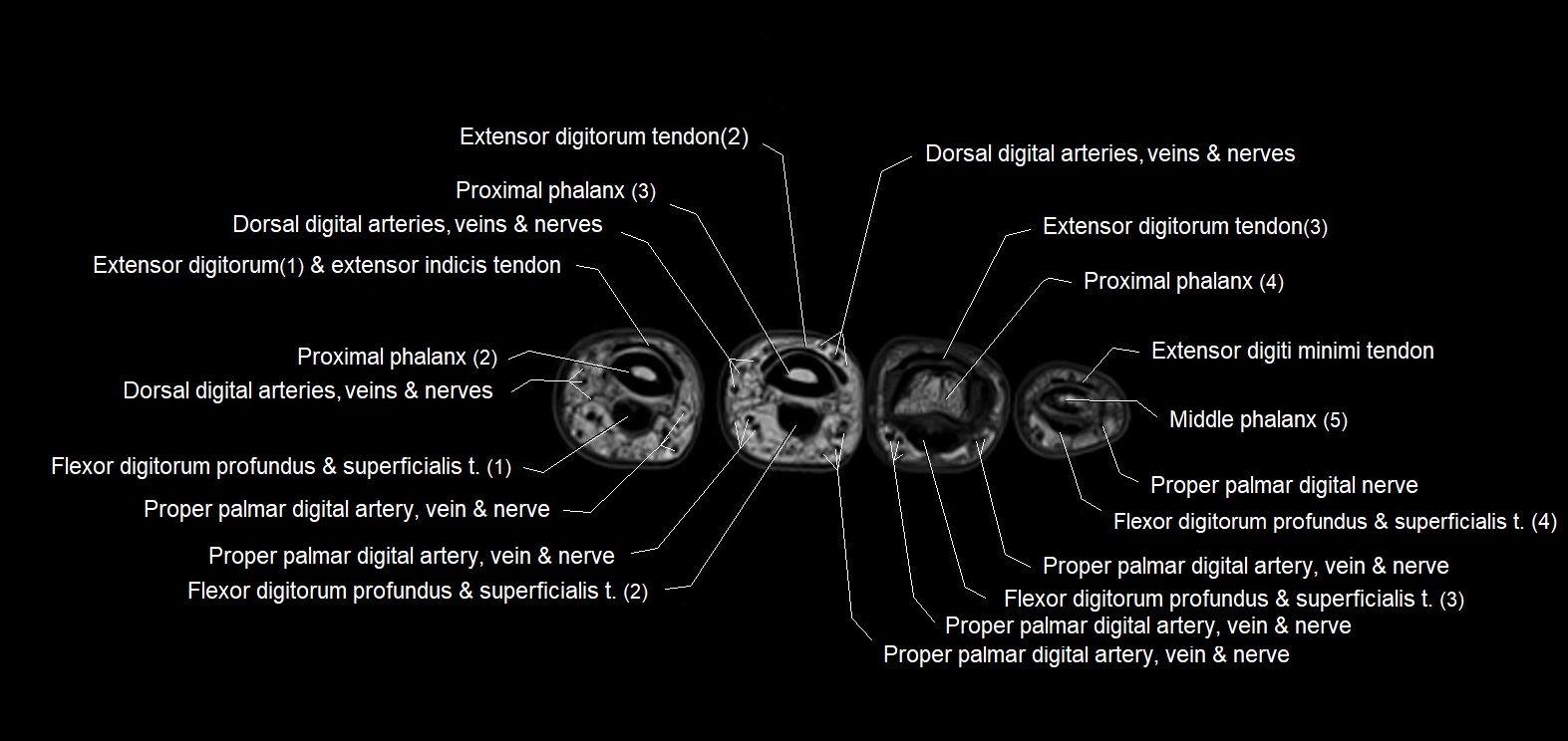 MRI Hand Anatomy – Labeled Axial, Coronal & Sagittal Images
