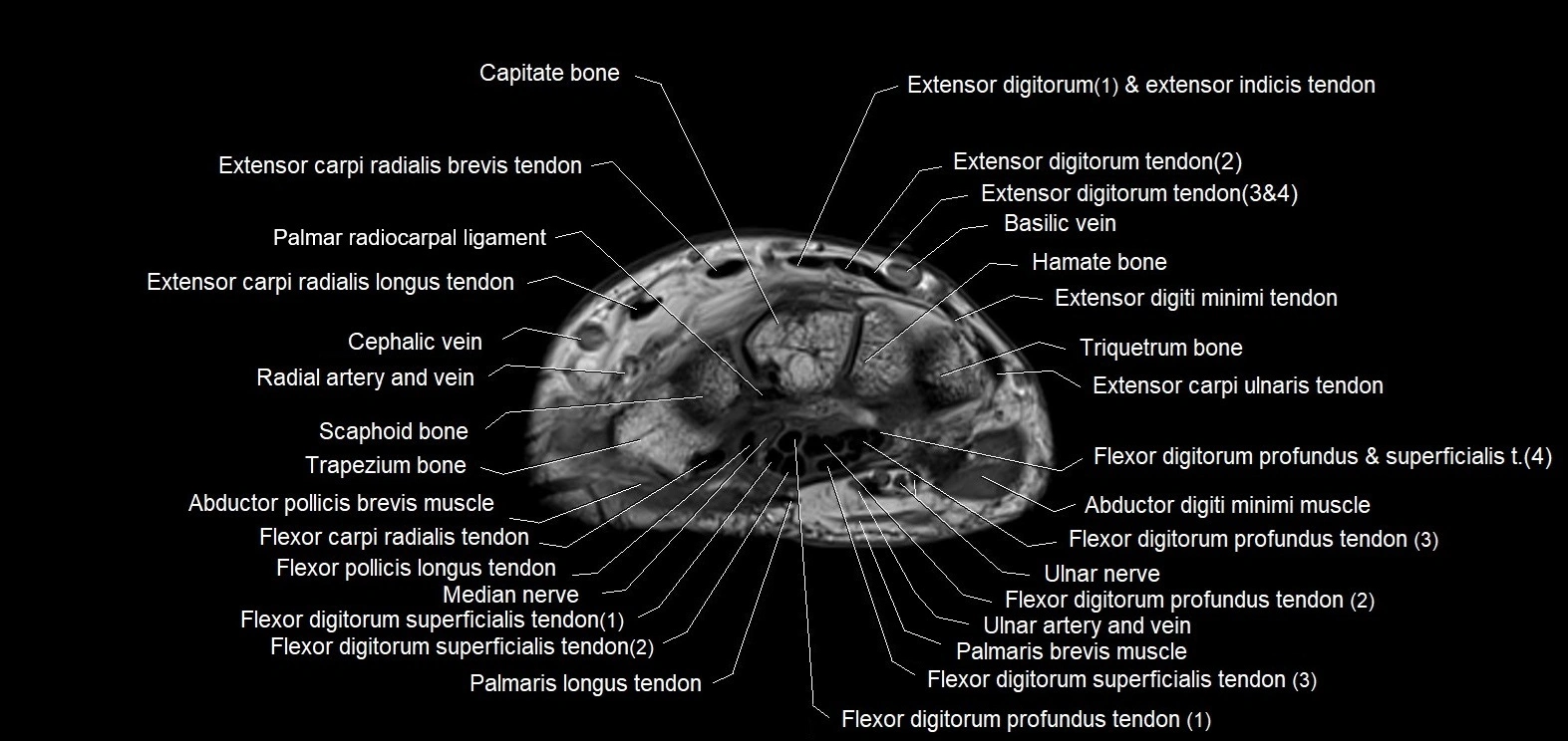 MRI Hand Anatomy – Labeled Axial, Coronal & Sagittal Images
