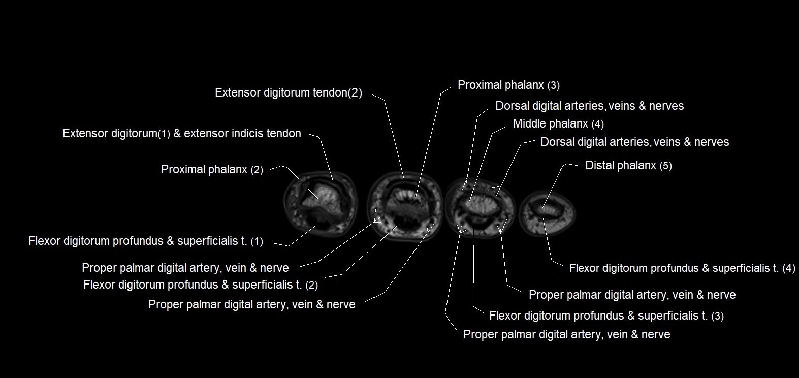 MRI Hand Anatomy – Labeled Axial, Coronal & Sagittal Images