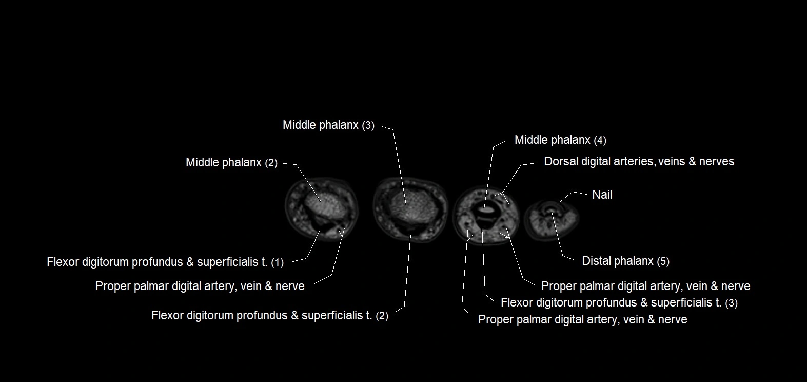 MRI Hand Anatomy – Labeled Axial, Coronal & Sagittal Images