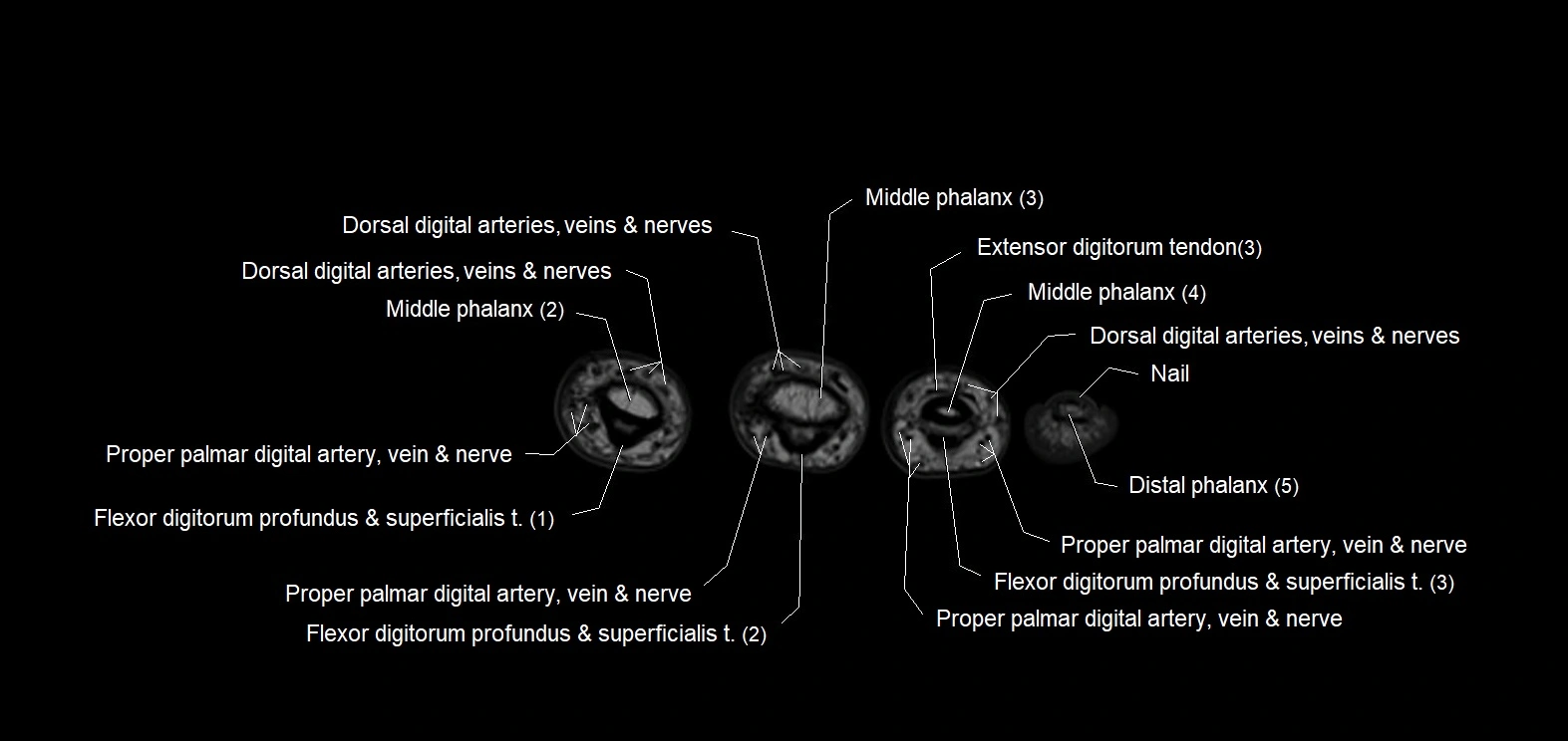 MRI Hand Anatomy – Labeled Axial, Coronal & Sagittal Images