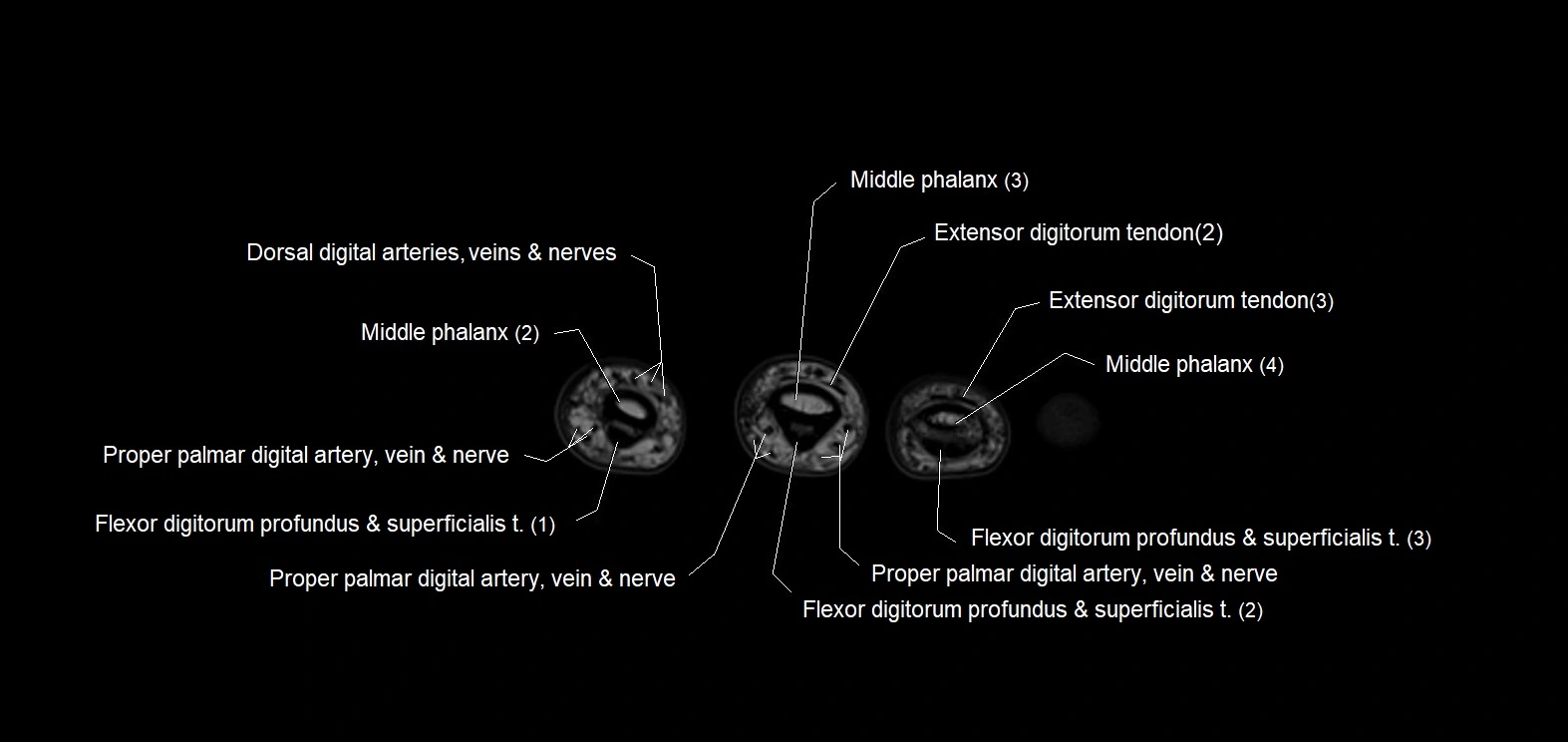MRI Hand Anatomy – Labeled Axial, Coronal & Sagittal Images