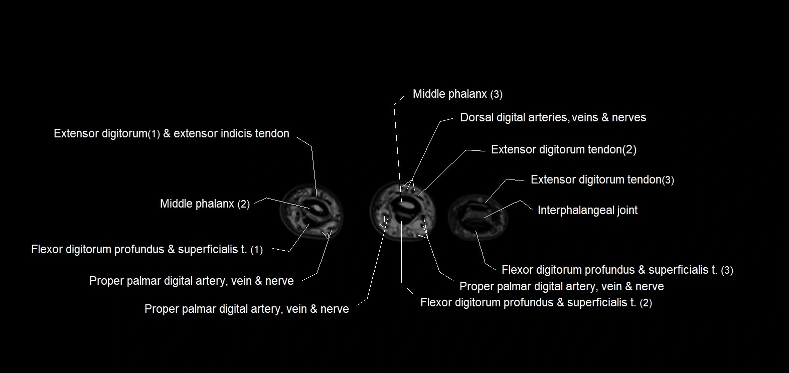 MRI Hand Anatomy – Labeled Axial, Coronal & Sagittal Images