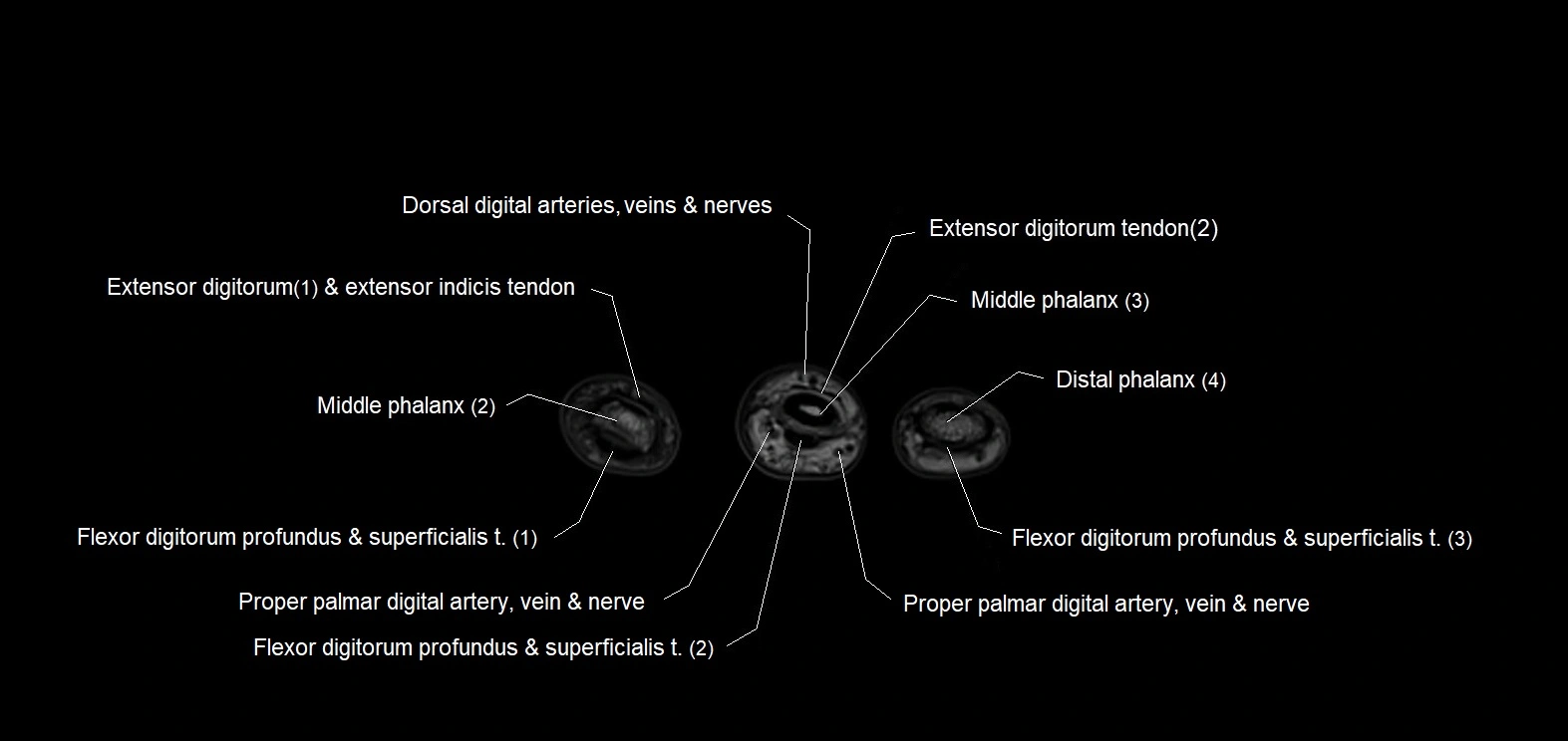 MRI Hand Anatomy – Labeled Axial, Coronal & Sagittal Images