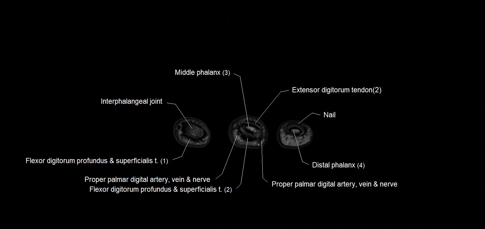 MRI Hand Anatomy – Labeled Axial, Coronal & Sagittal Images