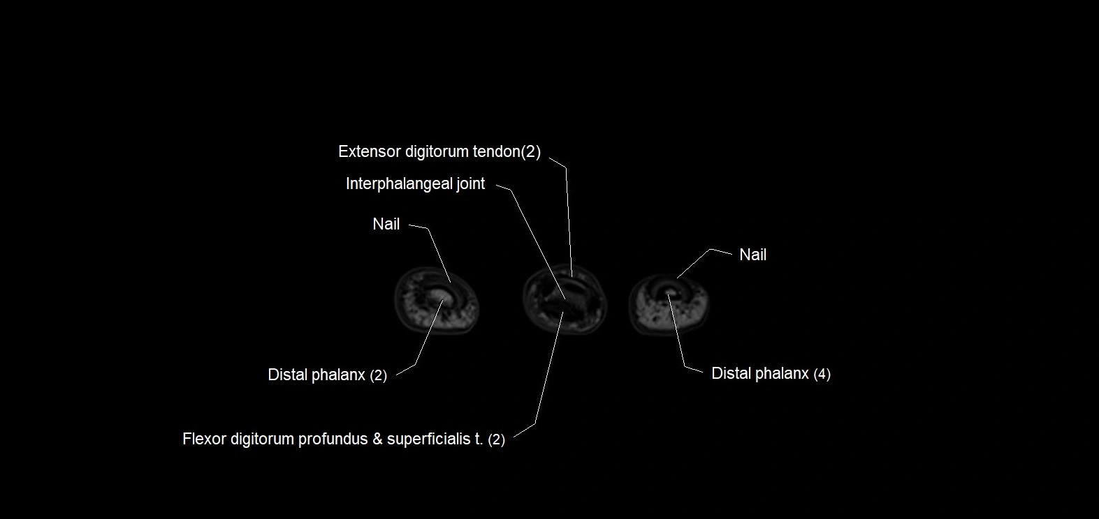MRI Hand Anatomy – Labeled Axial, Coronal & Sagittal Images