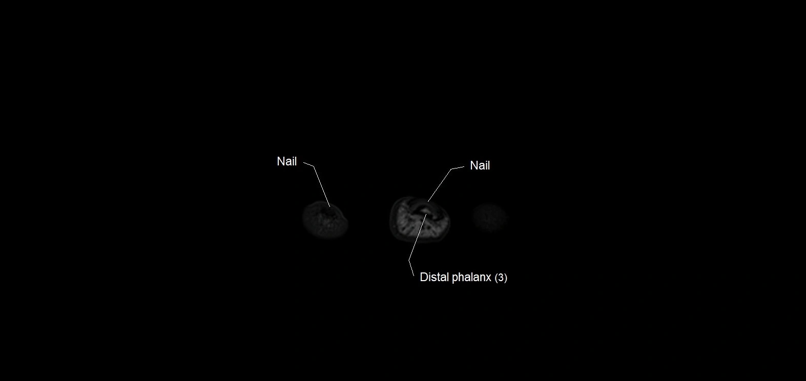MRI Hand Anatomy – Labeled Axial, Coronal & Sagittal Images