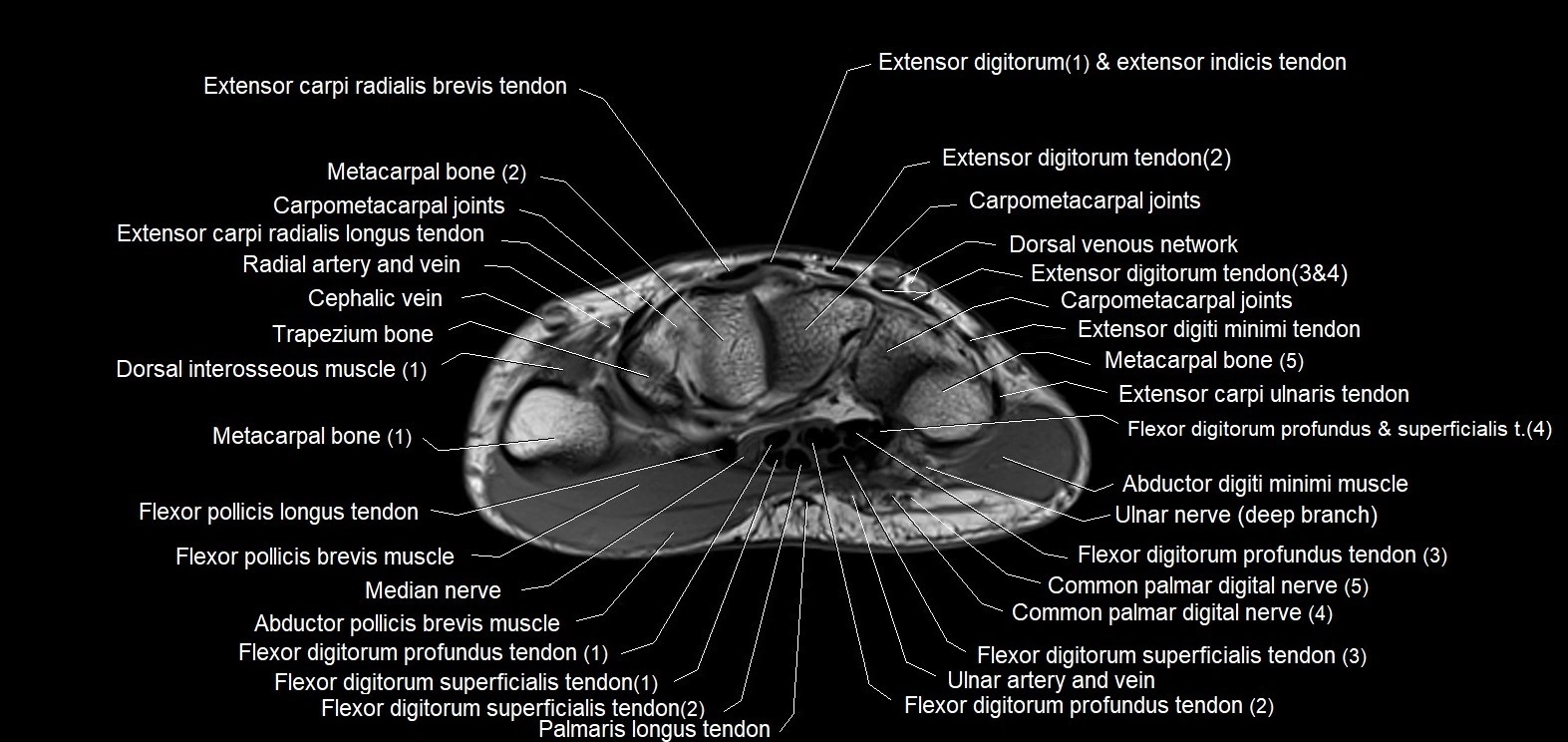 MRI Hand Anatomy – Labeled Axial, Coronal & Sagittal Images