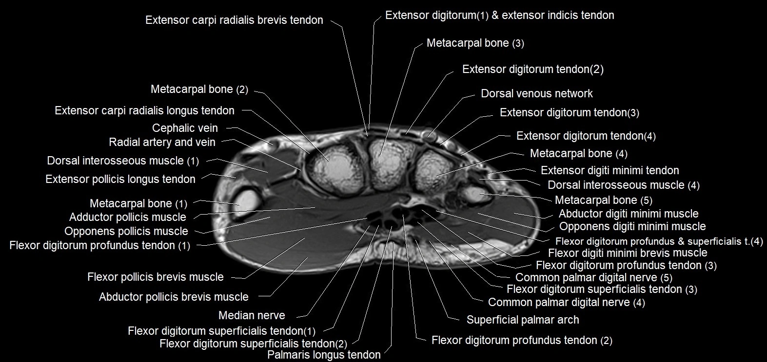 MRI Hand Anatomy – Labeled Axial, Coronal & Sagittal Images