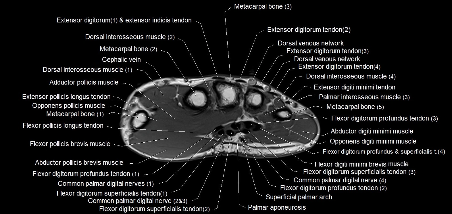 MRI Hand Anatomy – Labeled Axial, Coronal & Sagittal Images