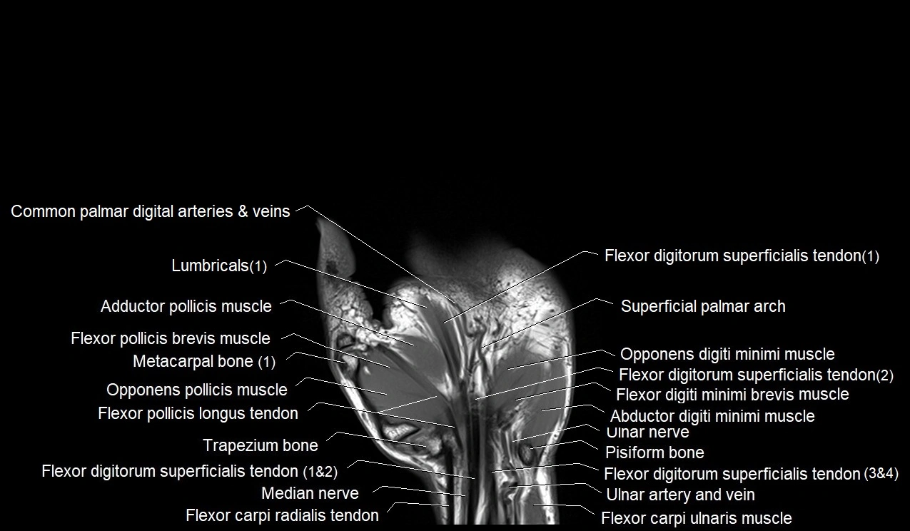 MRI Hand Anatomy – Labeled Axial, Coronal & Sagittal Images