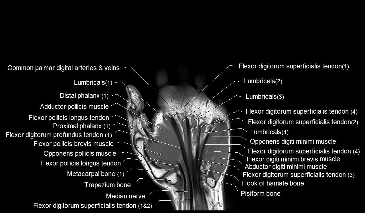 MRI Hand Anatomy – Labeled Axial, Coronal & Sagittal Images