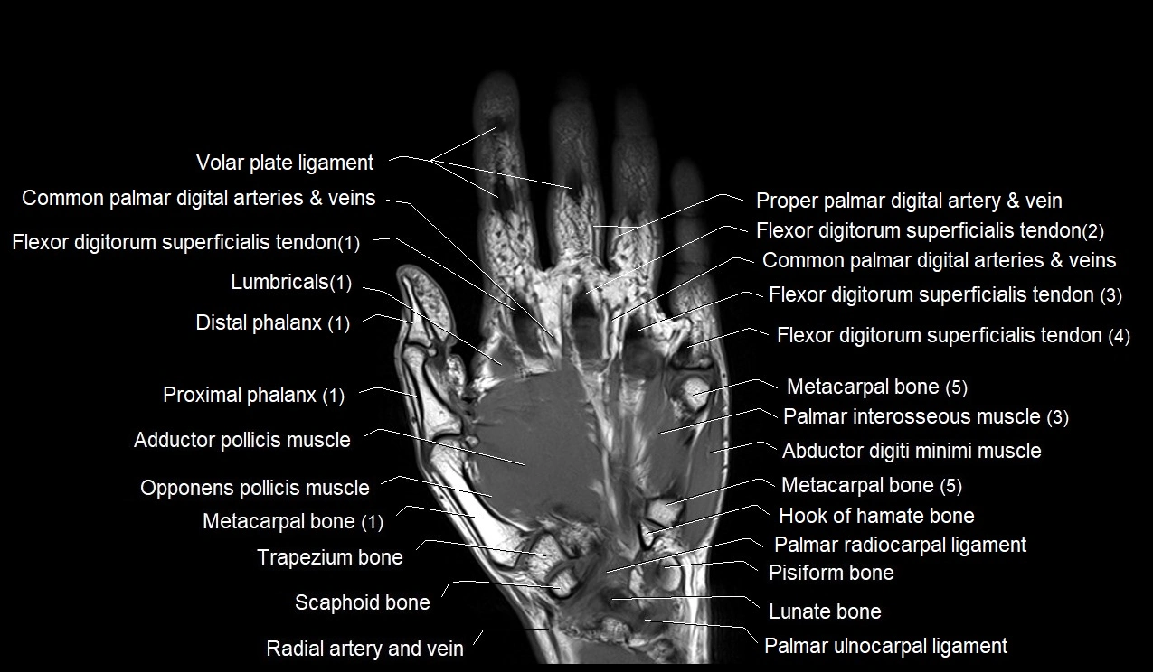 MRI Hand Anatomy – Labeled Axial, Coronal & Sagittal Images