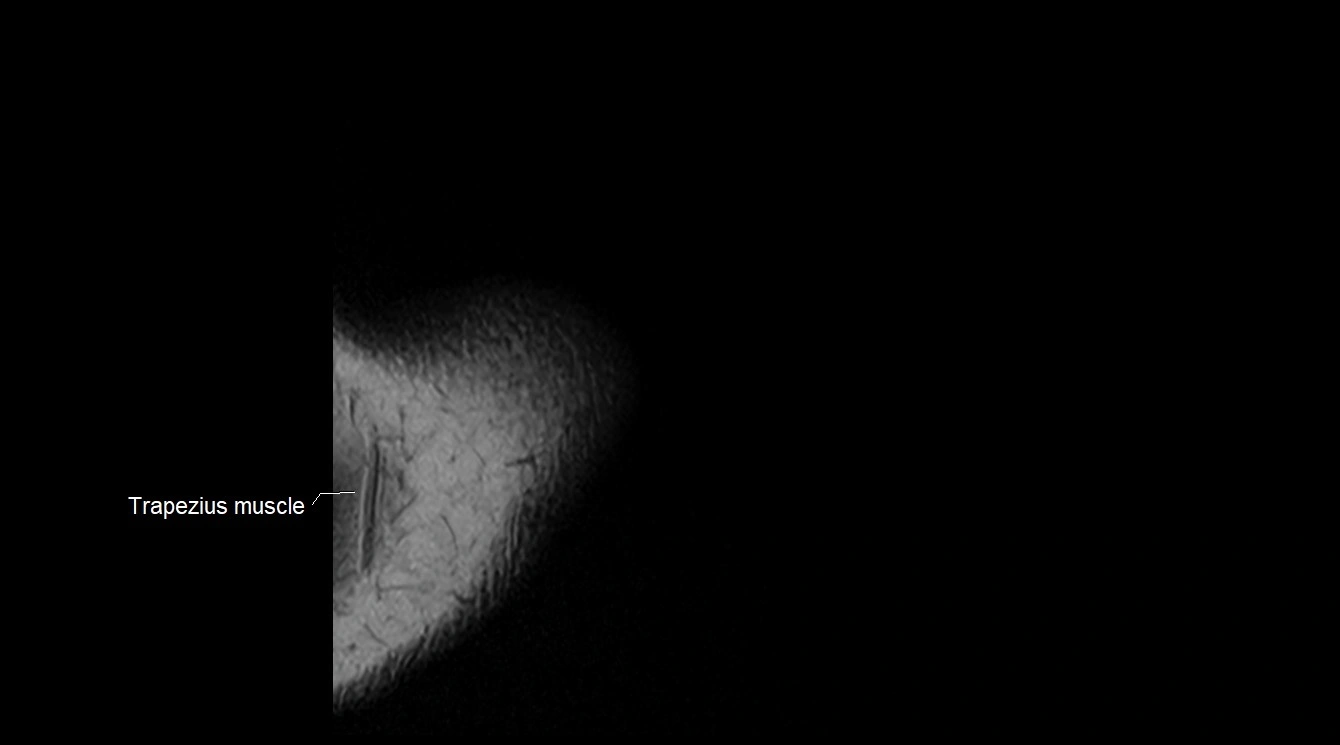 MRI Upper Arm Anatomy – Labeled Axial, Coronal & Sagittal MRI Cross ...