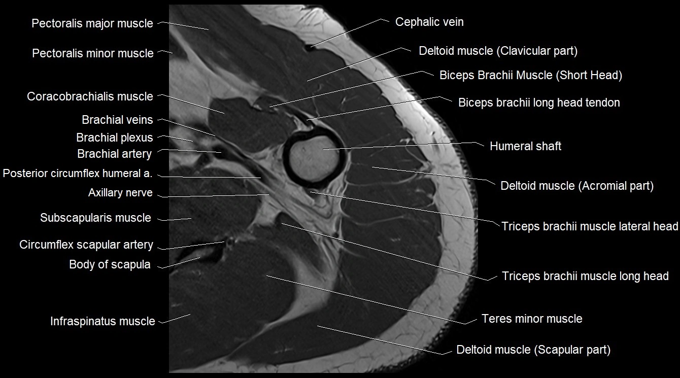 MRI Upper Arm Anatomy – Labeled Axial, Coronal & Sagittal MRI Cross ...